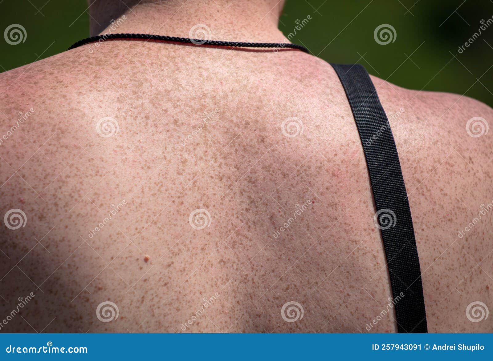 Freckle on the Back of a Man. Stock Image - Image of health, risk ...