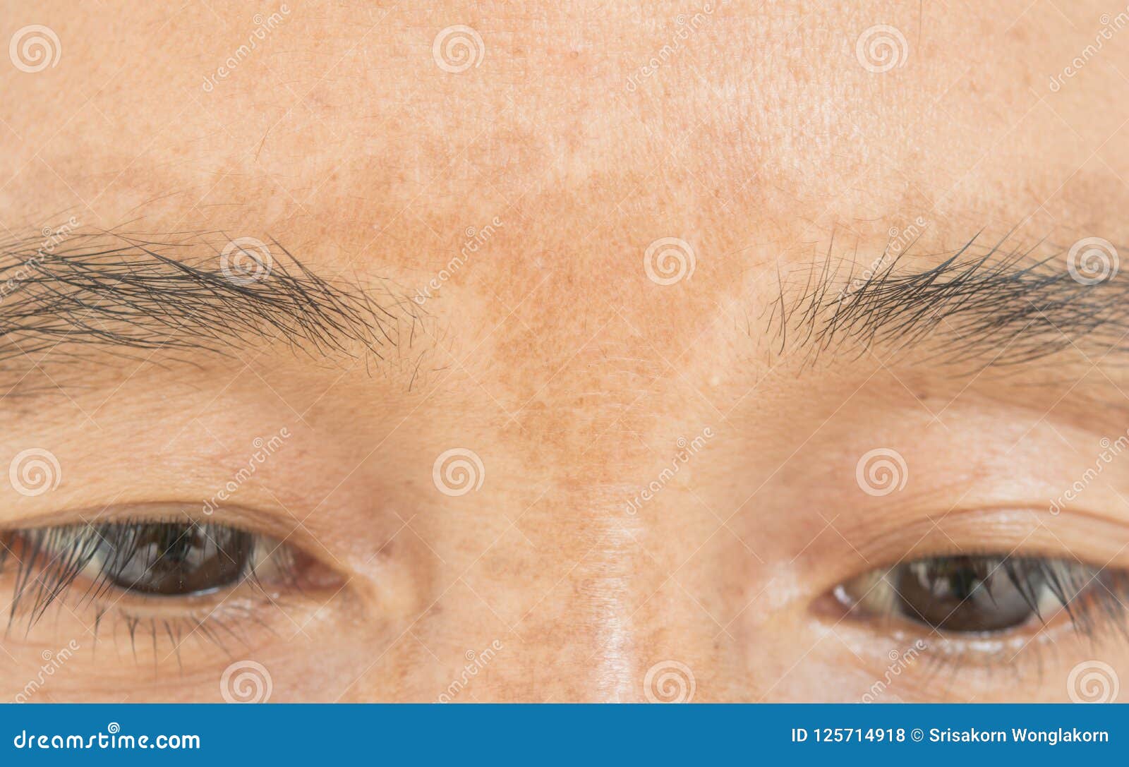 Freckles on the face stock photo. Image of problems - 125714918