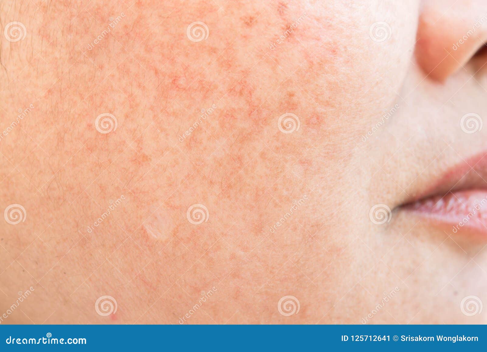 Freckles on the face stock image. Image of people, dermatology - 125712641