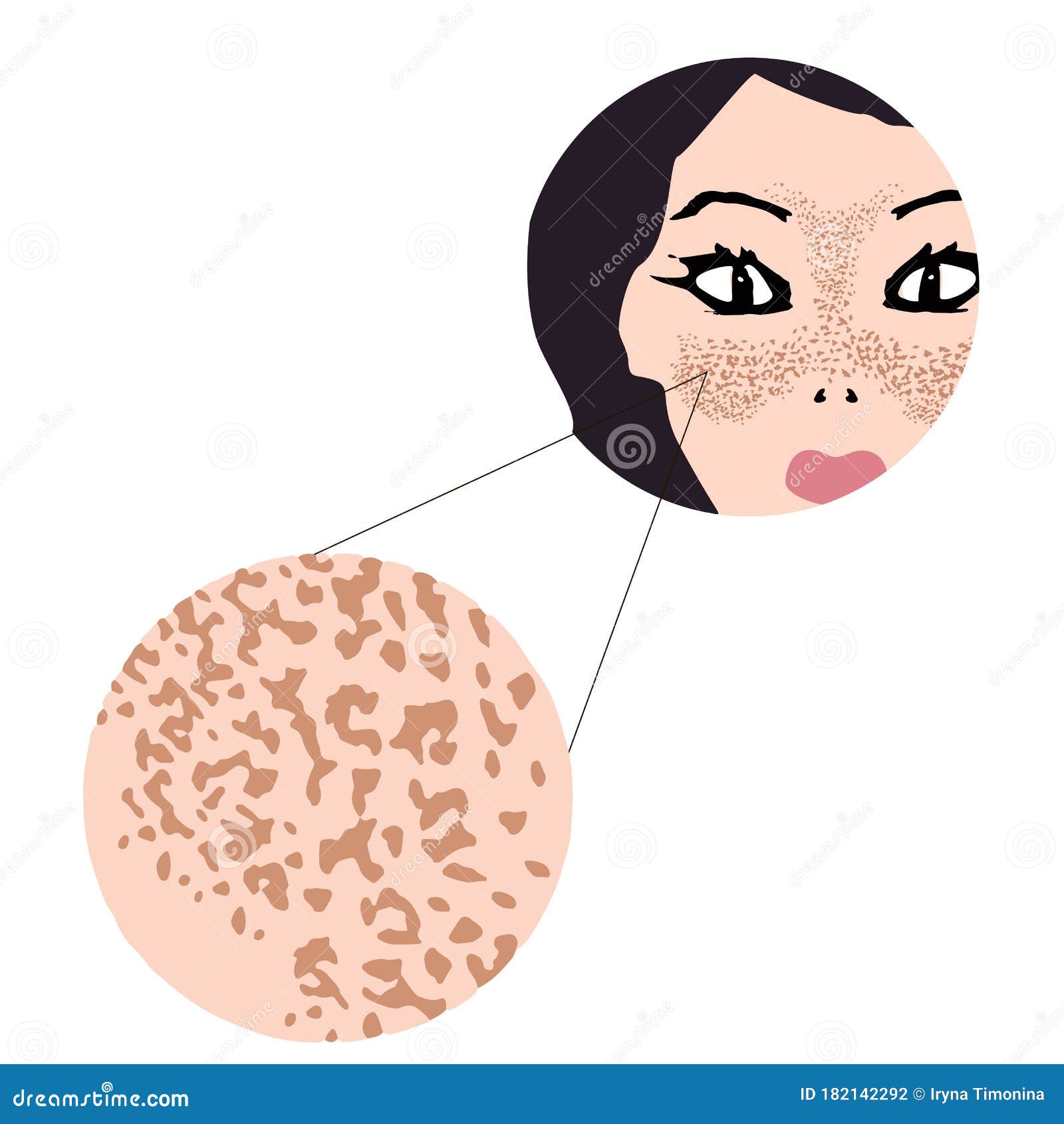 Pigmented Spots On The Skin. Skin Problem. Pigmentation. Closeup Brown ...