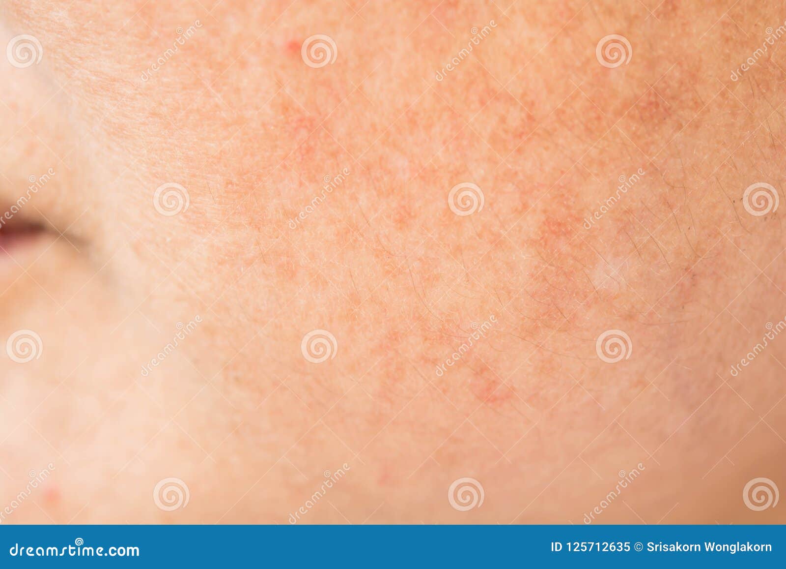 Freckles on the face stock image. Image of face, health - 125712635