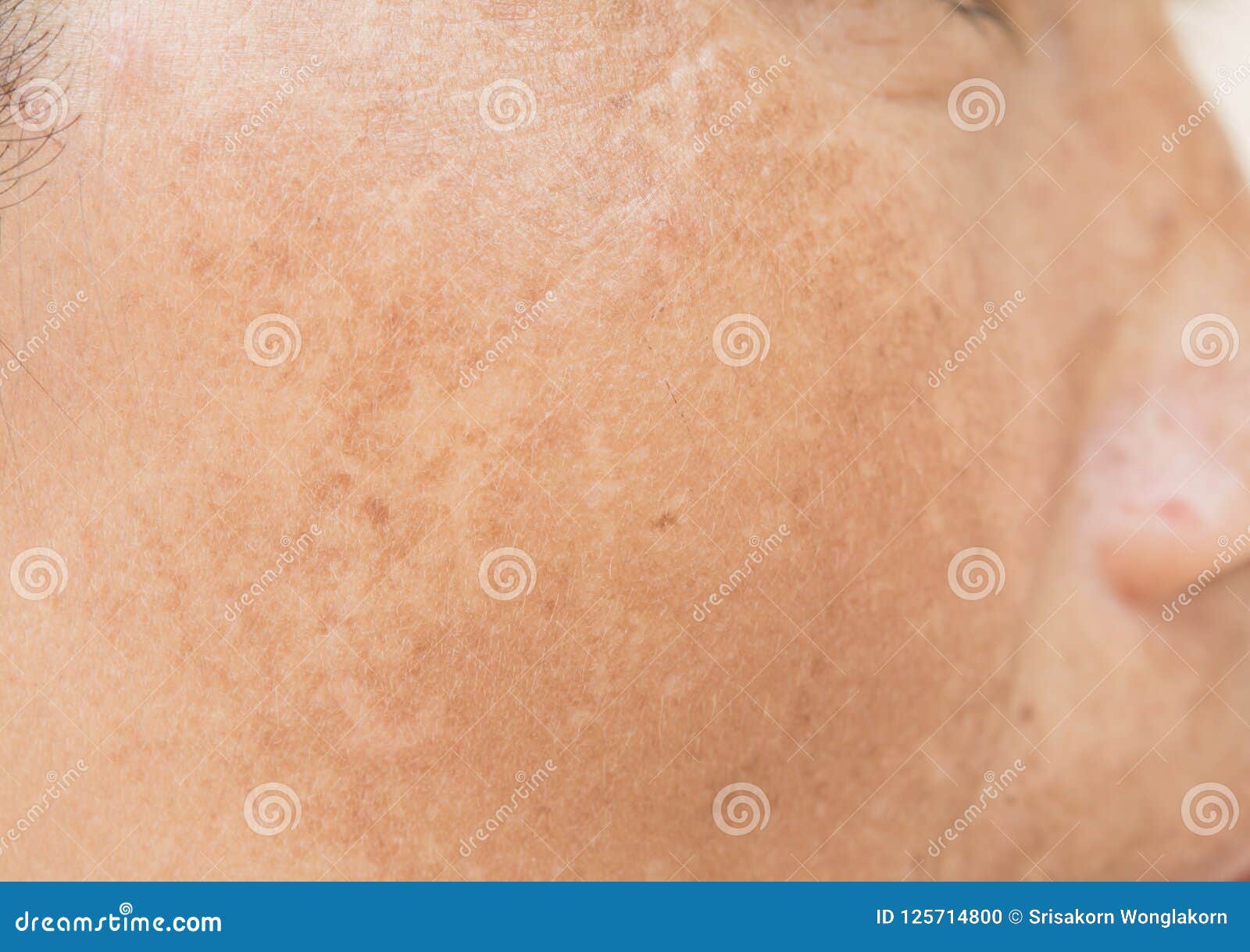 Freckles on the face stock photo. Image of facial, girl - 125714800