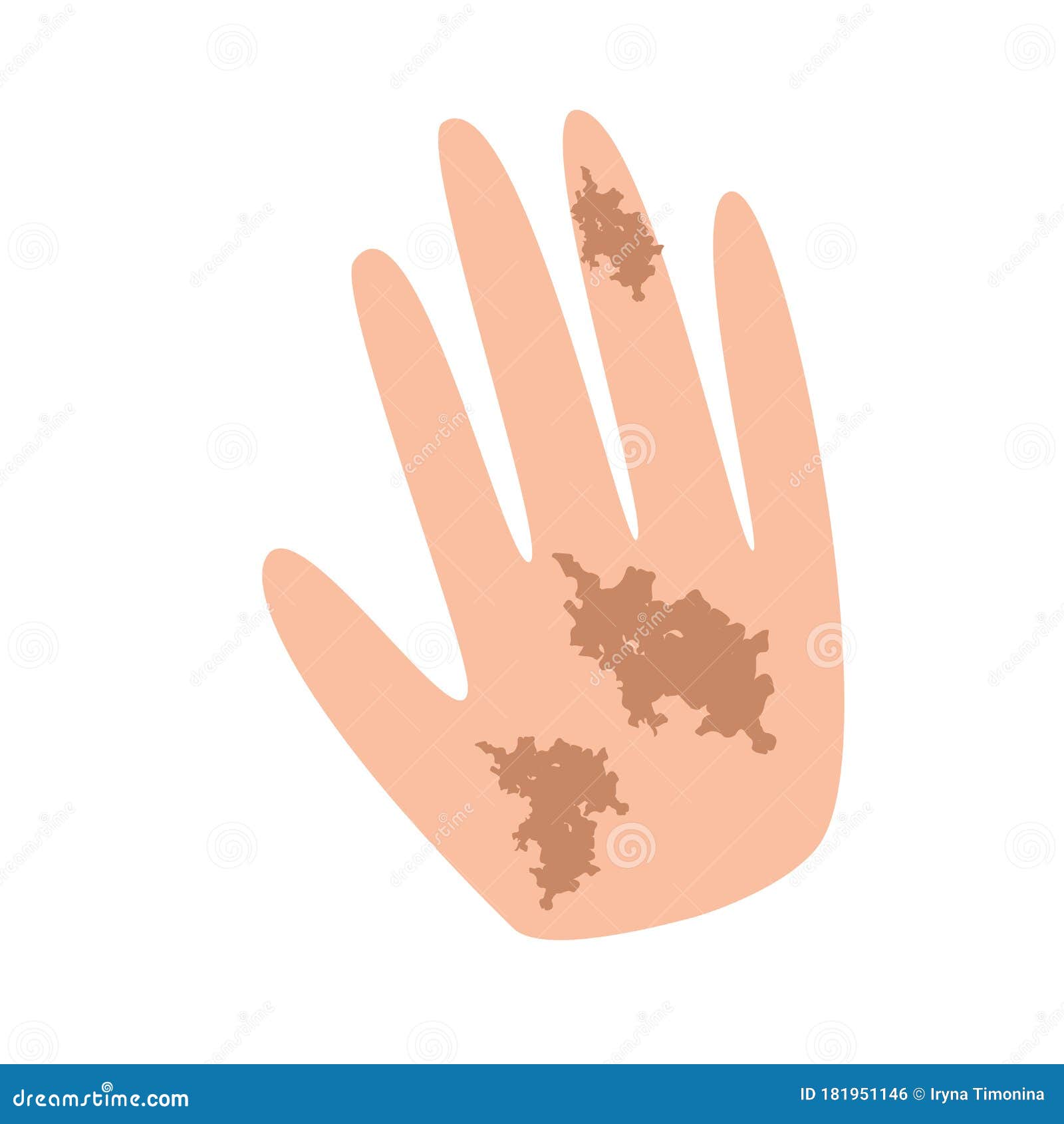 Pigmentation On The Skin Causes. Brown Spots On The Skin. Pigmentation ...