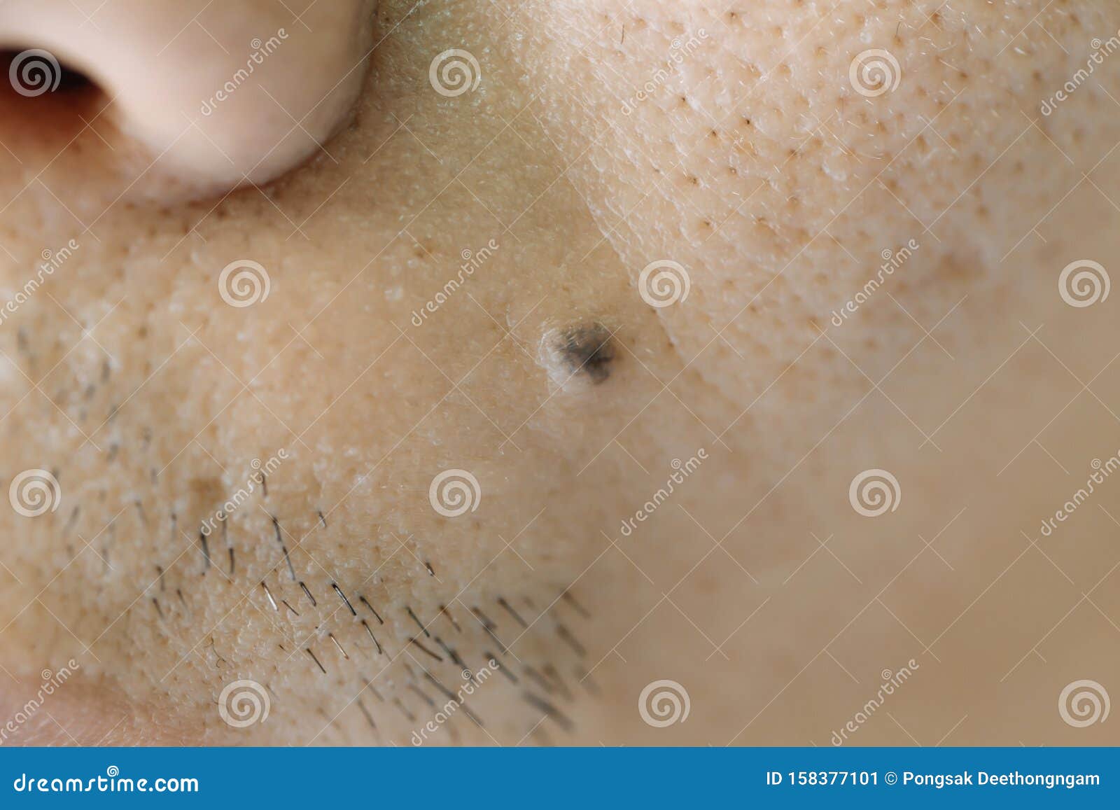 Asian Face Skin Problems stock image. Image of portrait - 158377101