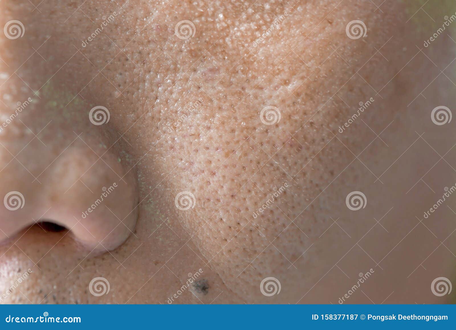 Asian Face, Skin Problems stock image. Image of beauty - 158377187