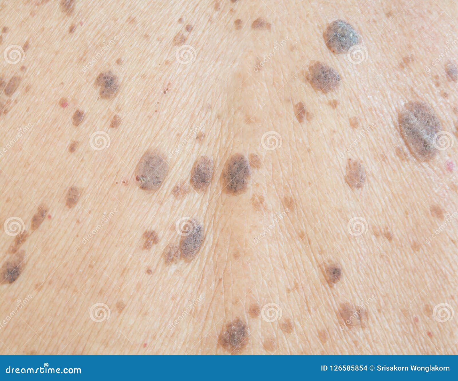 Freckles on the skin stock photo. Image of problem, aging - 126585854