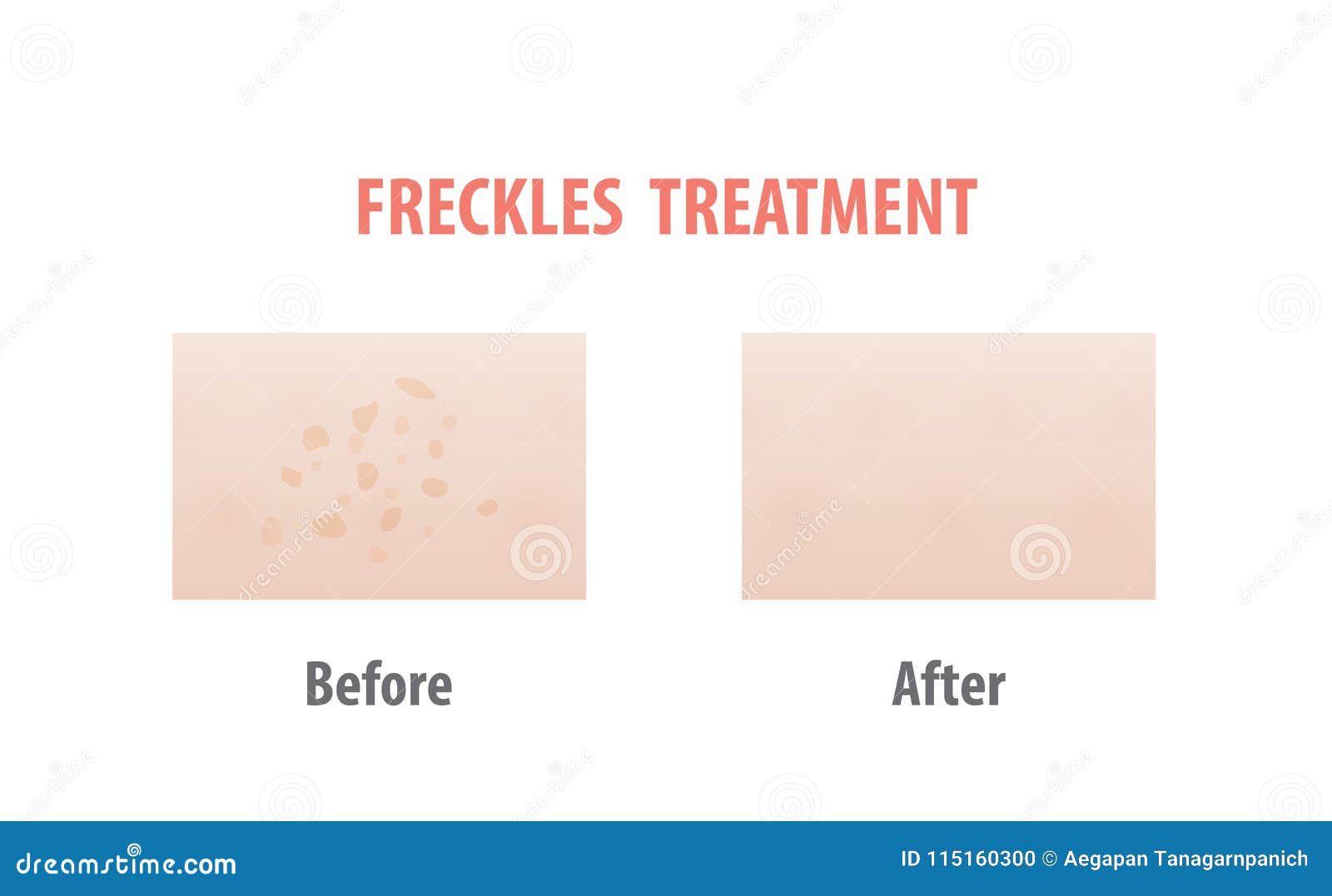 Freckles Treatment Comparison Illustration Vector On White Background ...