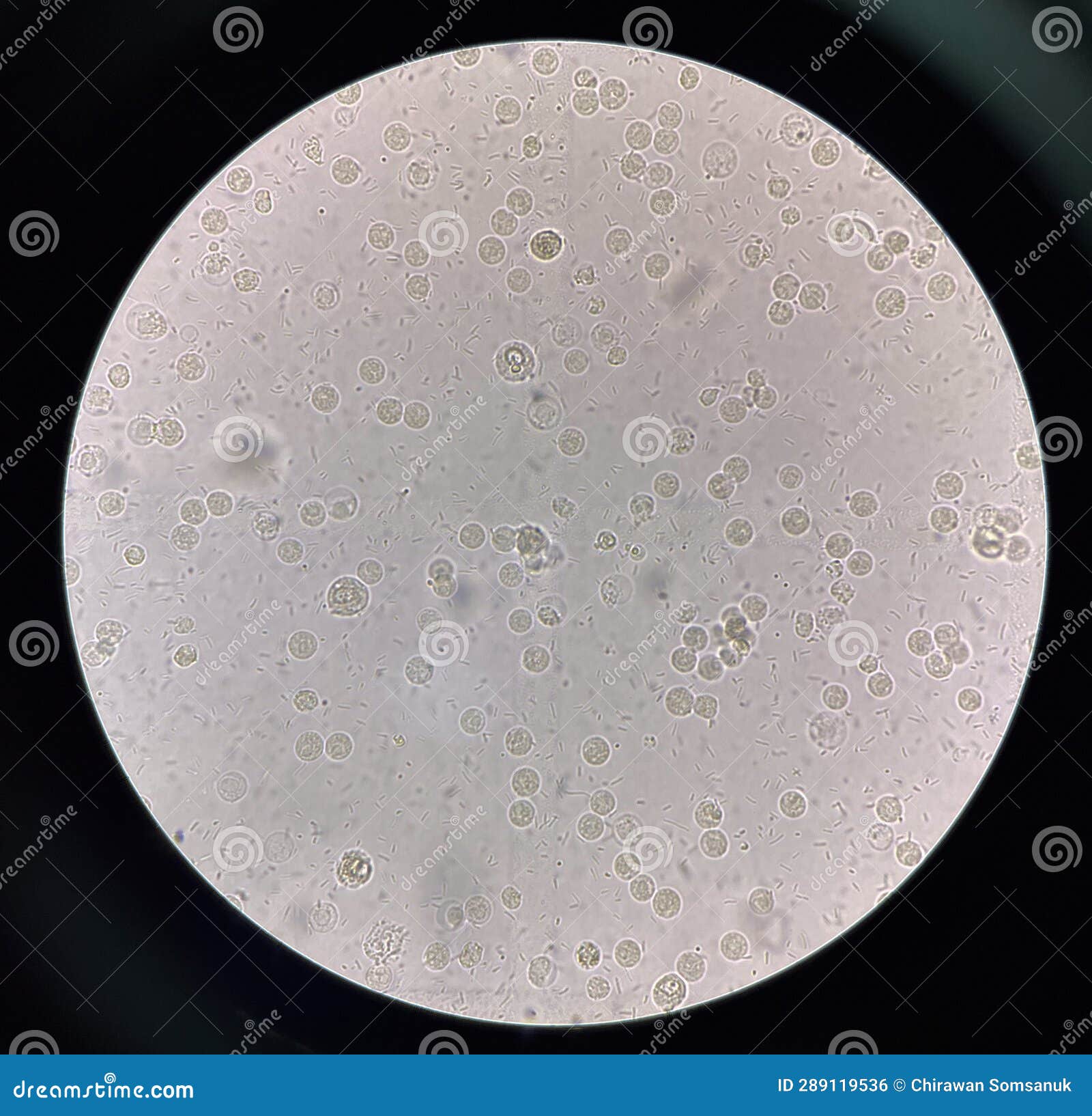 Fresh Bacteria Cell in Urine Sample Stock Photo - Image of microbe ...