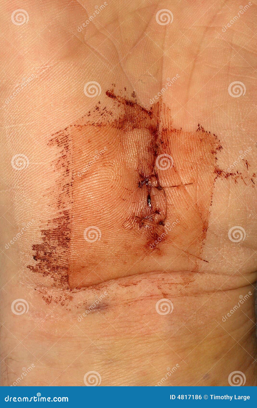 Fresh operation scar stock photo. Image of scar, stitches - 4817186