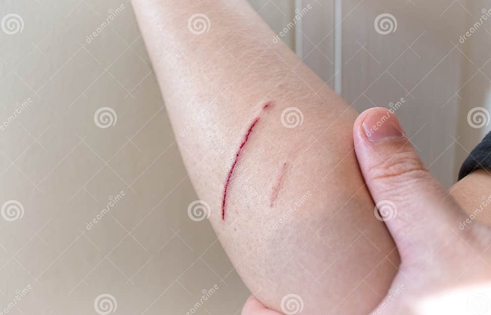 Fresh Wound of Deep Skin Scratch on the Forearm . Stock Photo - Image ...