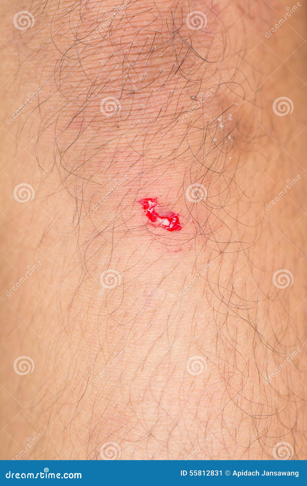 Fresh wounds stock image. Image of caucasian, infection - 55812831