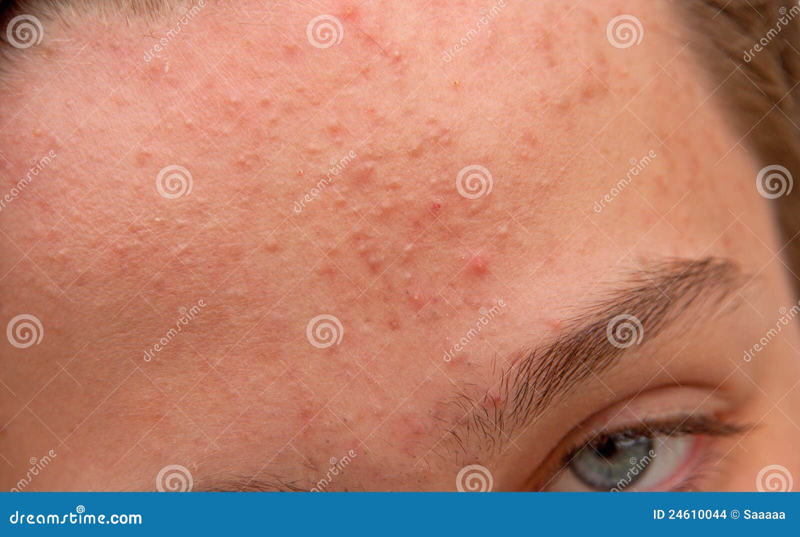 Front d'acné photo stock. Image du adolescent, soin, adolescents - 24610044