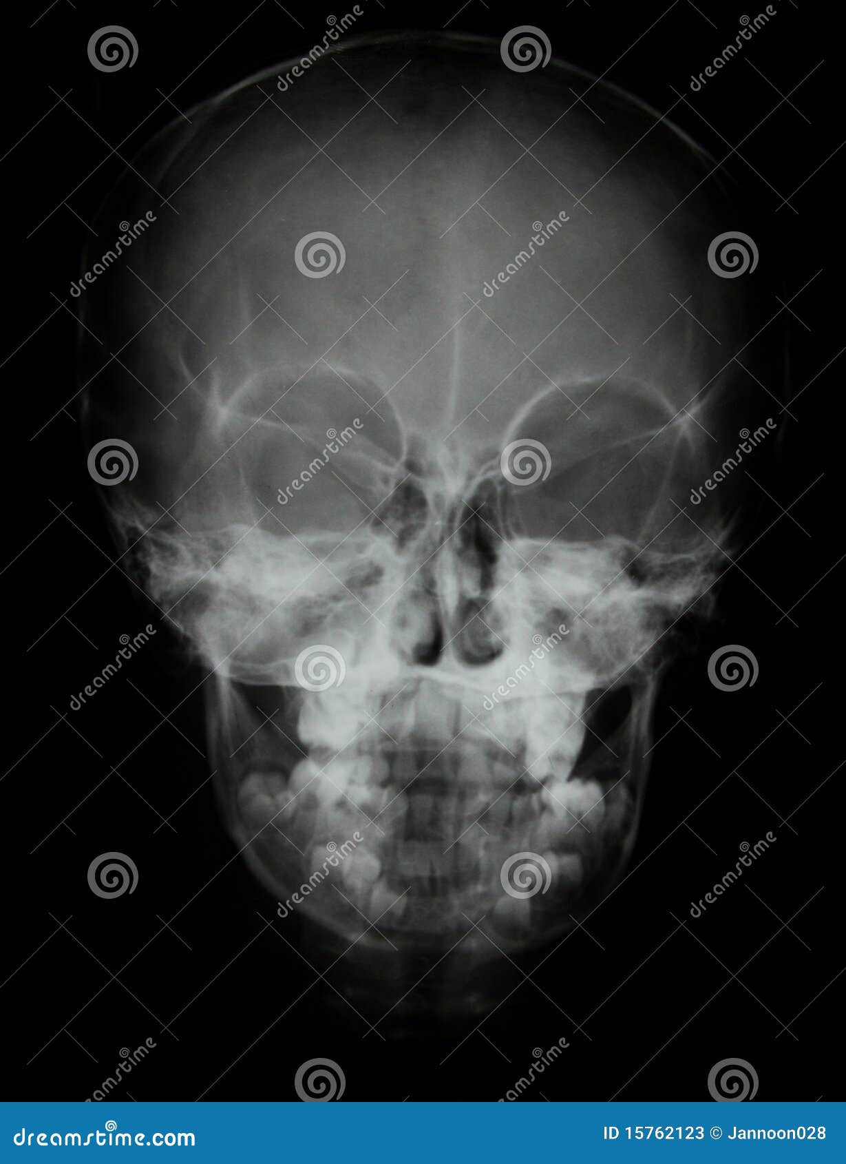 Front Face Skull X-ray Image Stock Image - Image of health, segment ...