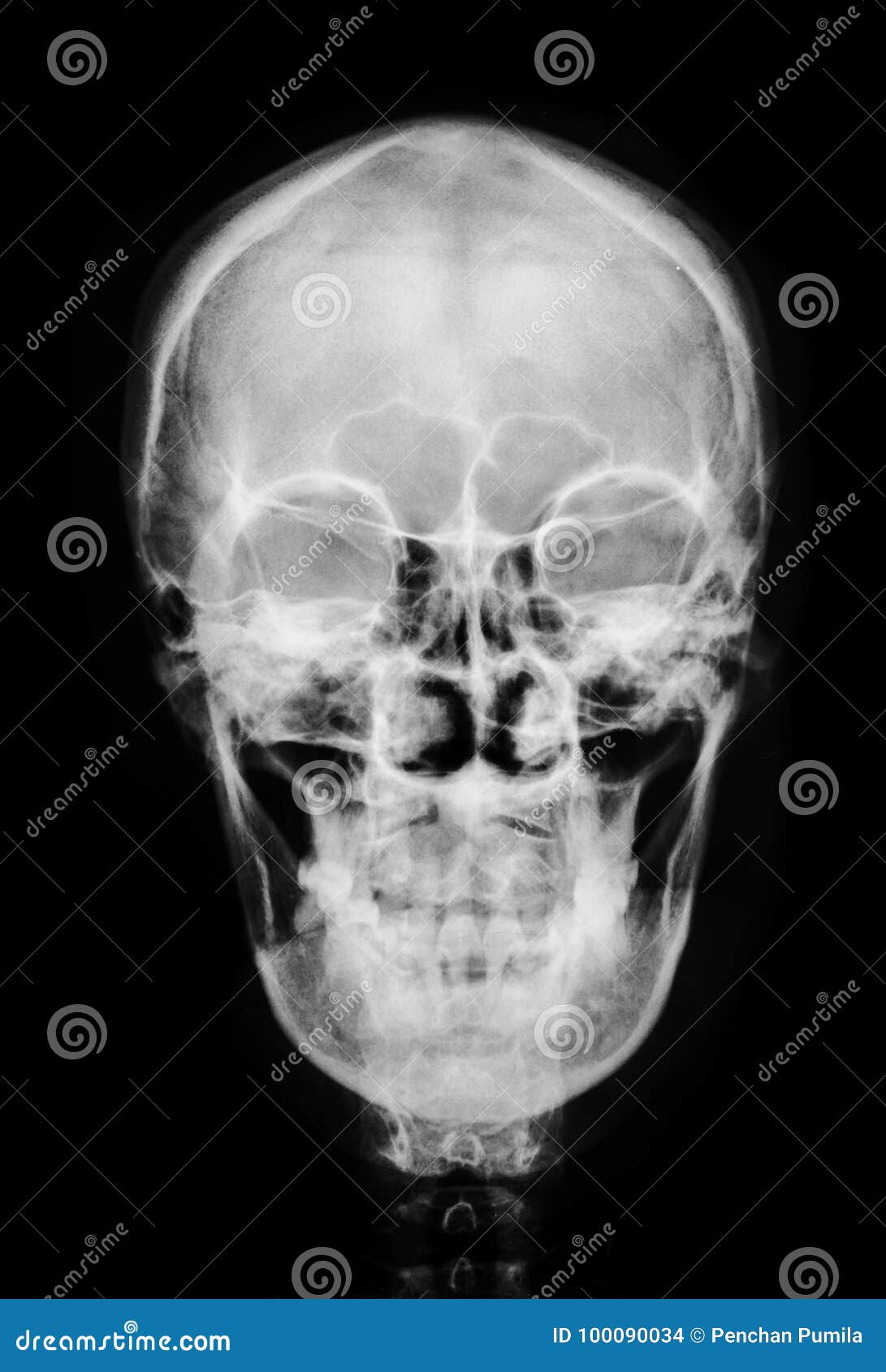Front face skull x-ray. stock photo. Image of examination - 100090034