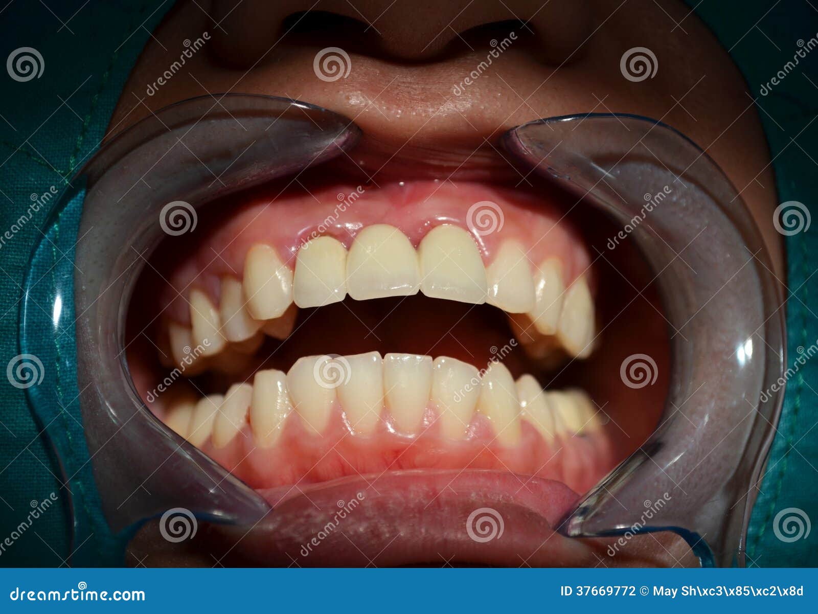 Front Side of Upper and Lower Teeth Stock Photo - Image of saliva ...