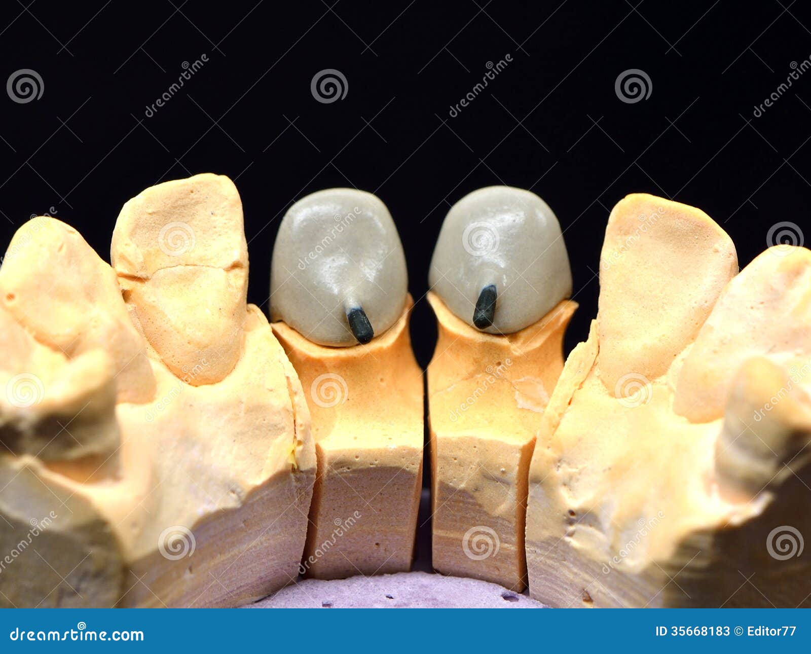 Front teeth dental implant stock image. Image of bridge - 35668183