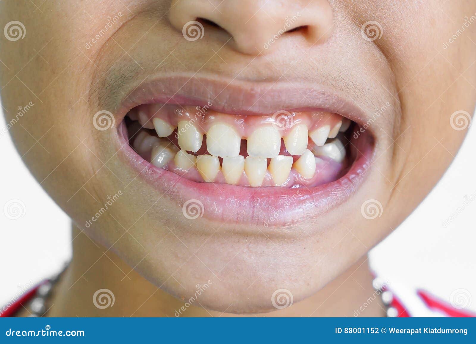 Front teeth gaps stock photo. Image of asian, upper, children - 88001152