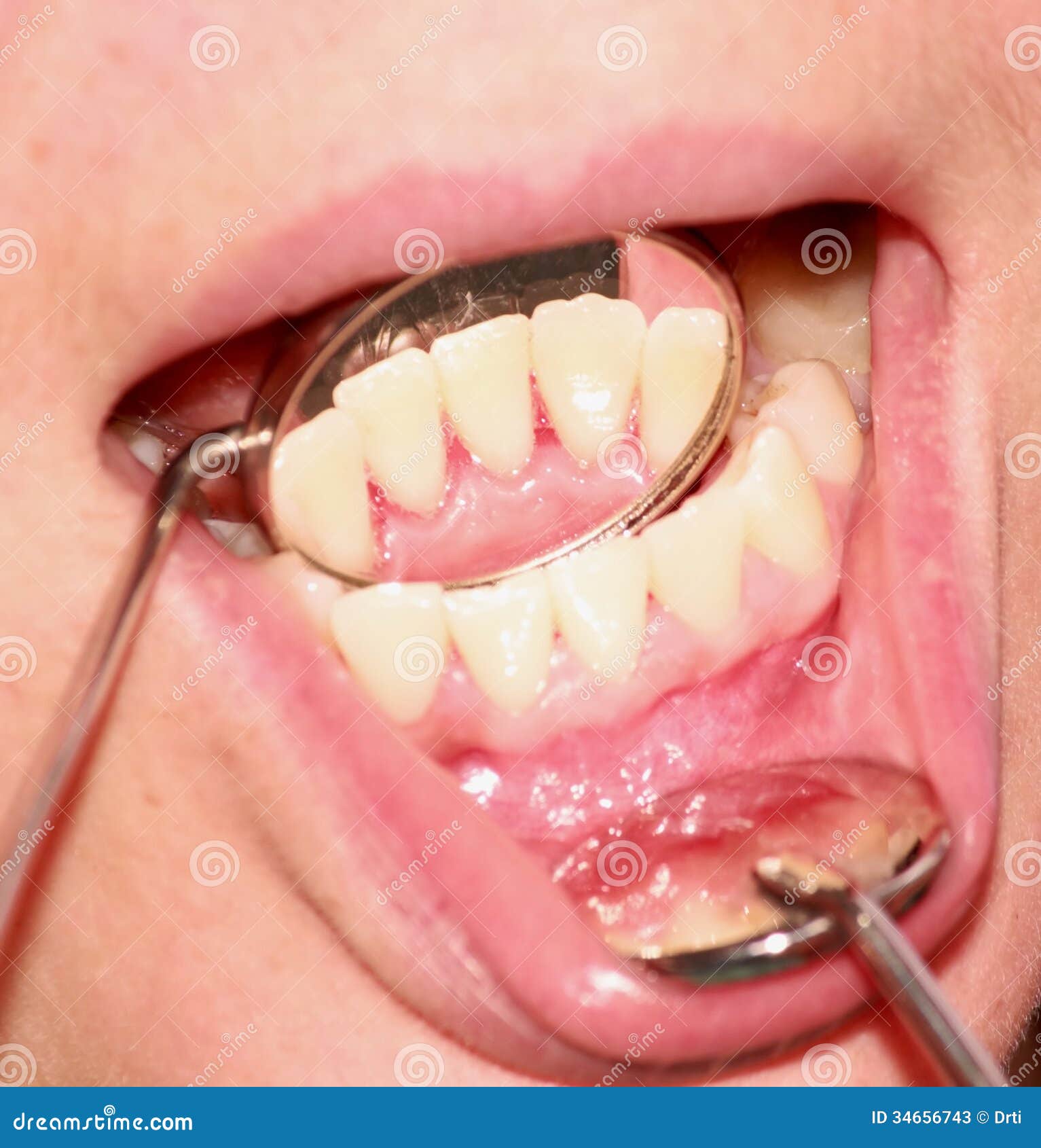Front Teeth after Removal of Tartar Stock Image - Image of patient ...