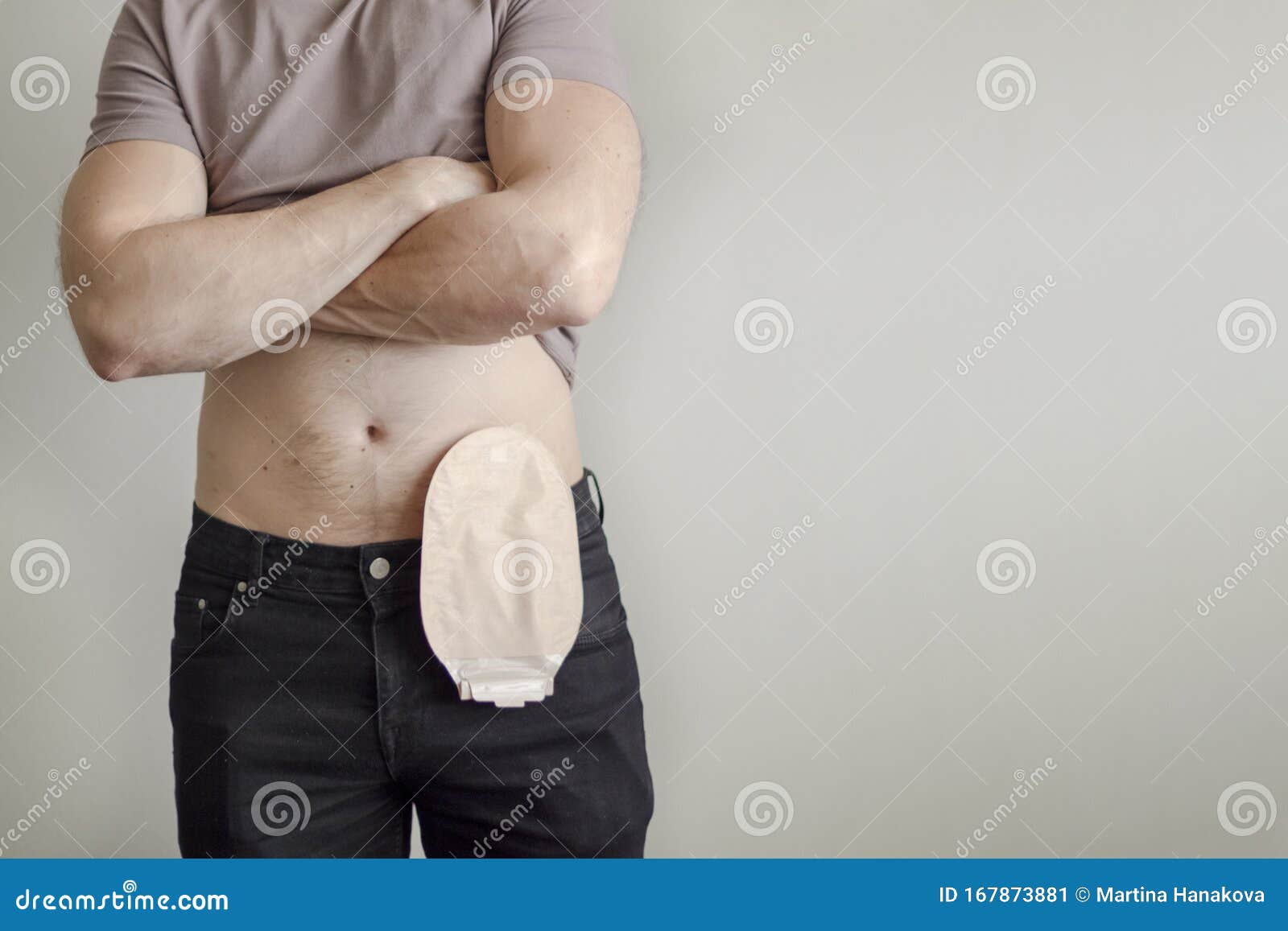 Front View On Colostomy Bag Attached To Man Patient Medical Theme Selective Focus On Skin