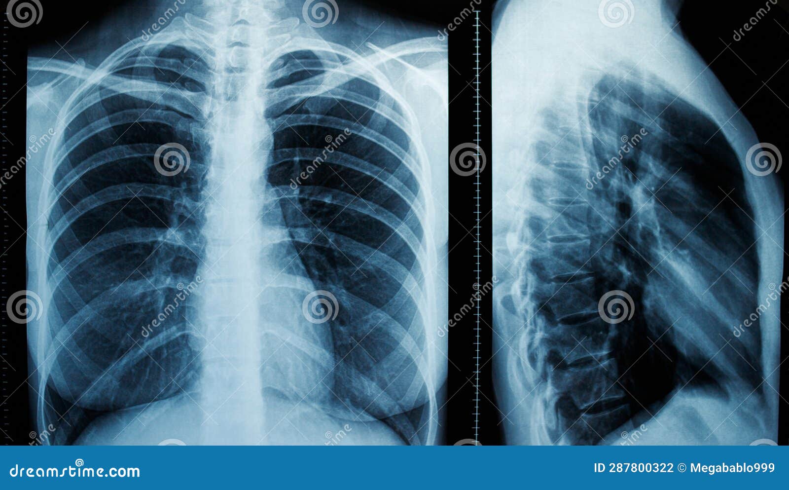 Frontal and Lateral Projections of a Female Chest X-ray Stock Photo ...