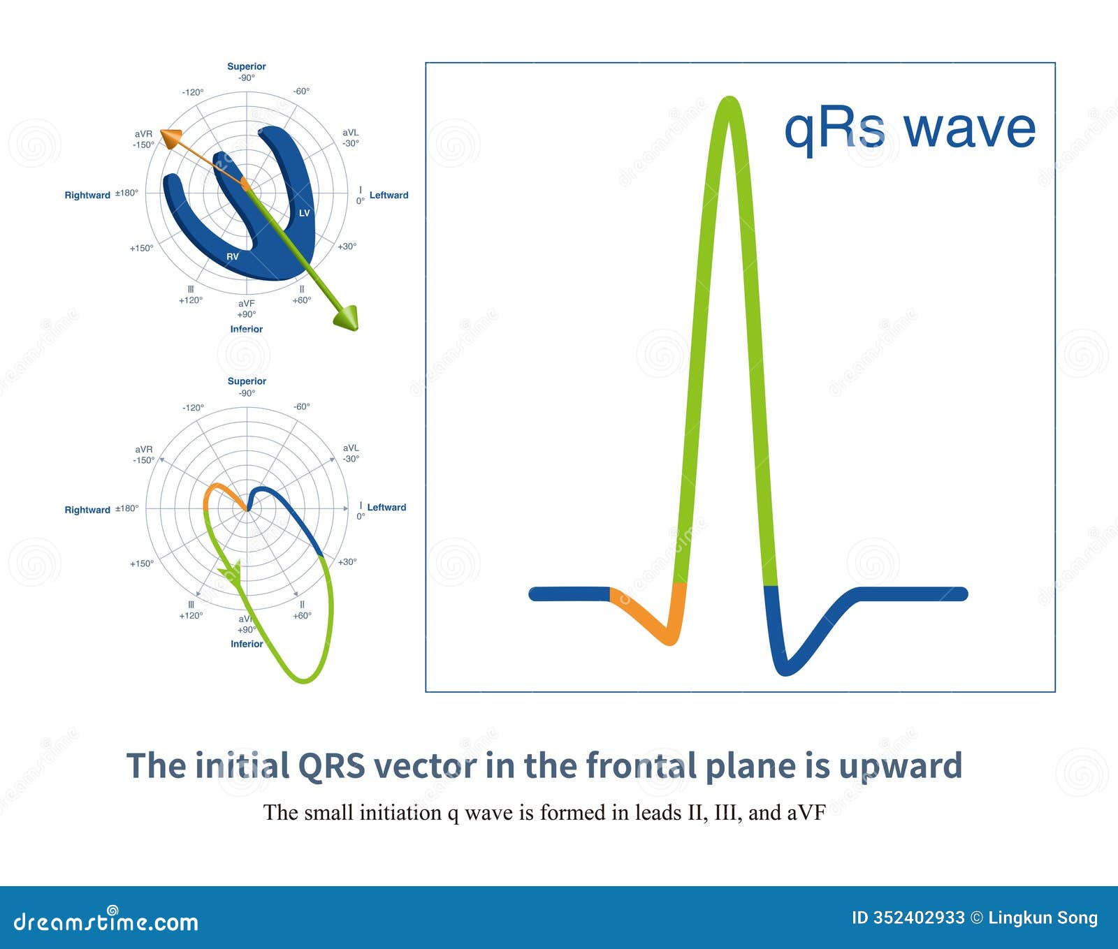 The Initial QRS Vector in the Frontal Plane is Upward Stock ...