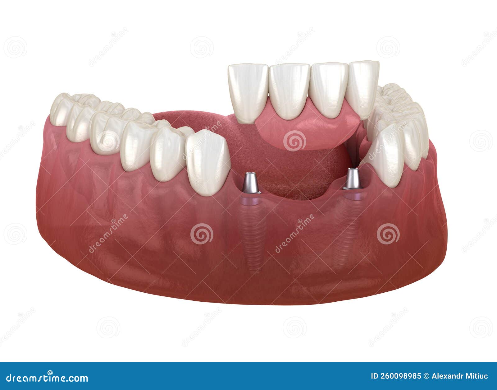 Frontal Teeth Bridge Supported by Implants. Medically Accurate 3D ...