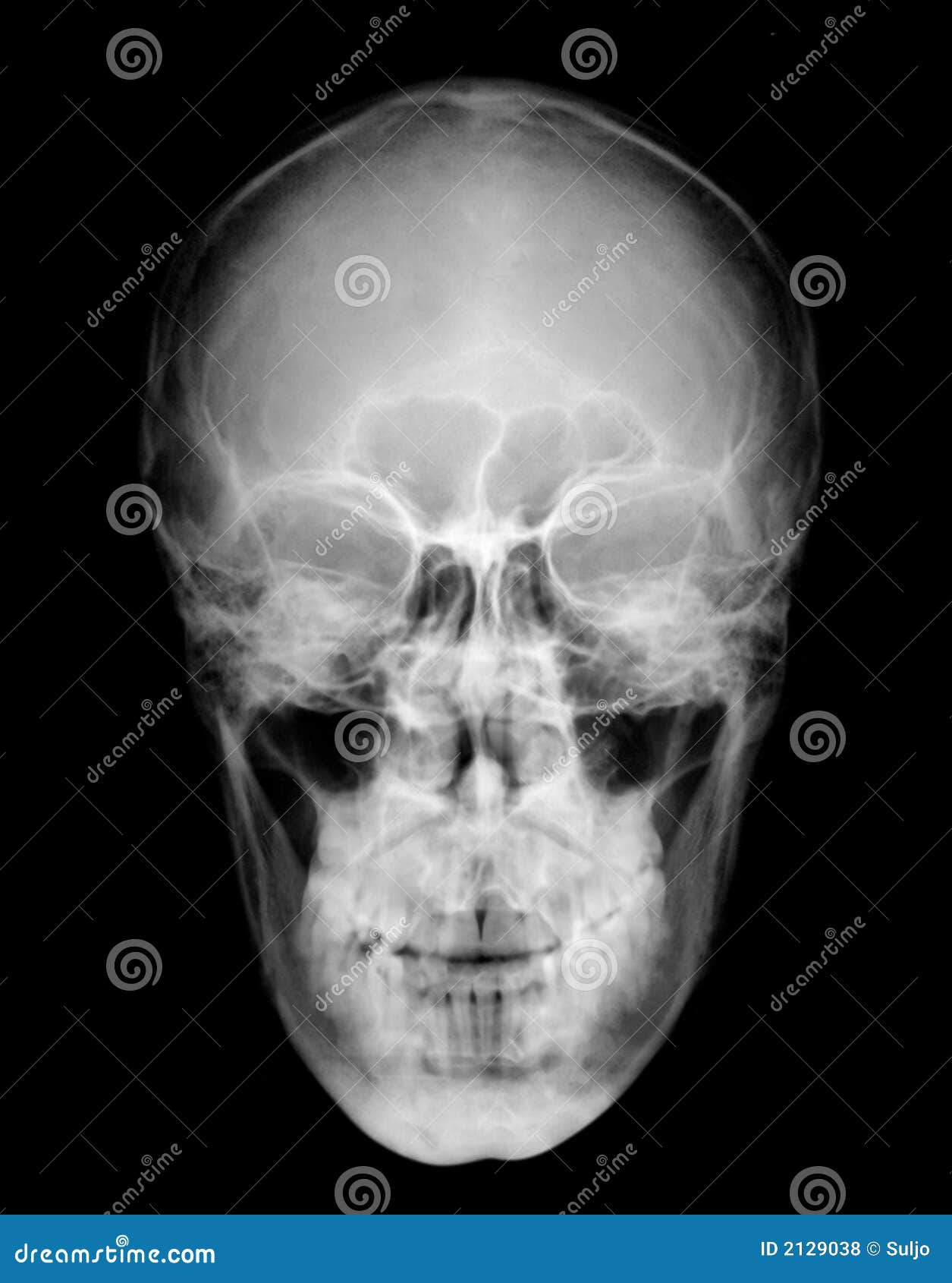 FrontHead stock photo. Image of trauma, medicine, medical - 2129038
