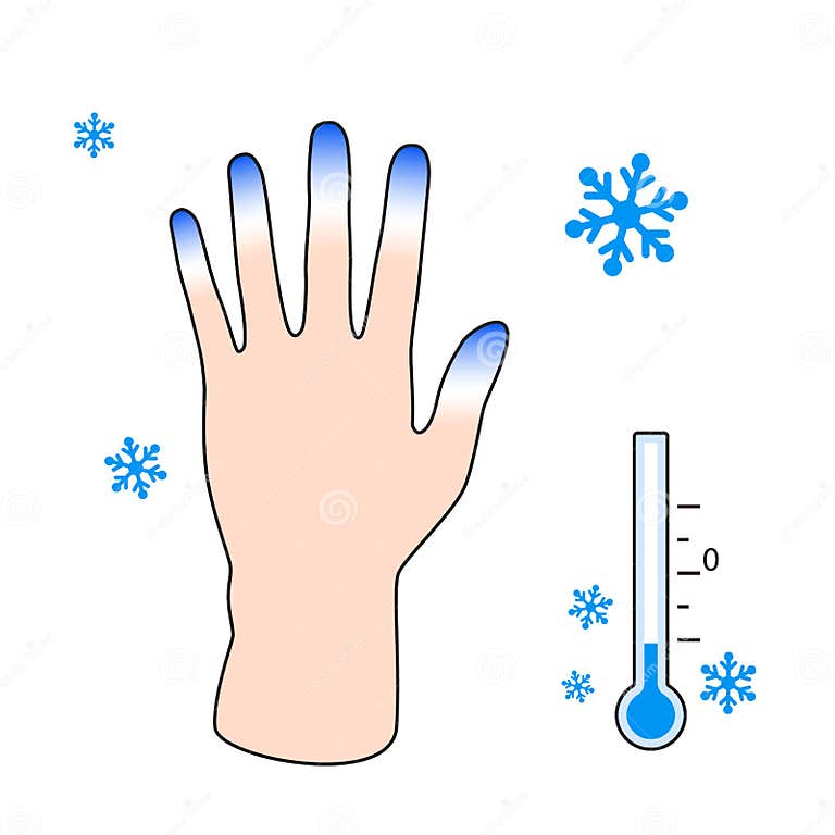 Frostbite. Hand with Frostbite Symptoms. Effect of Cold on Human ...
