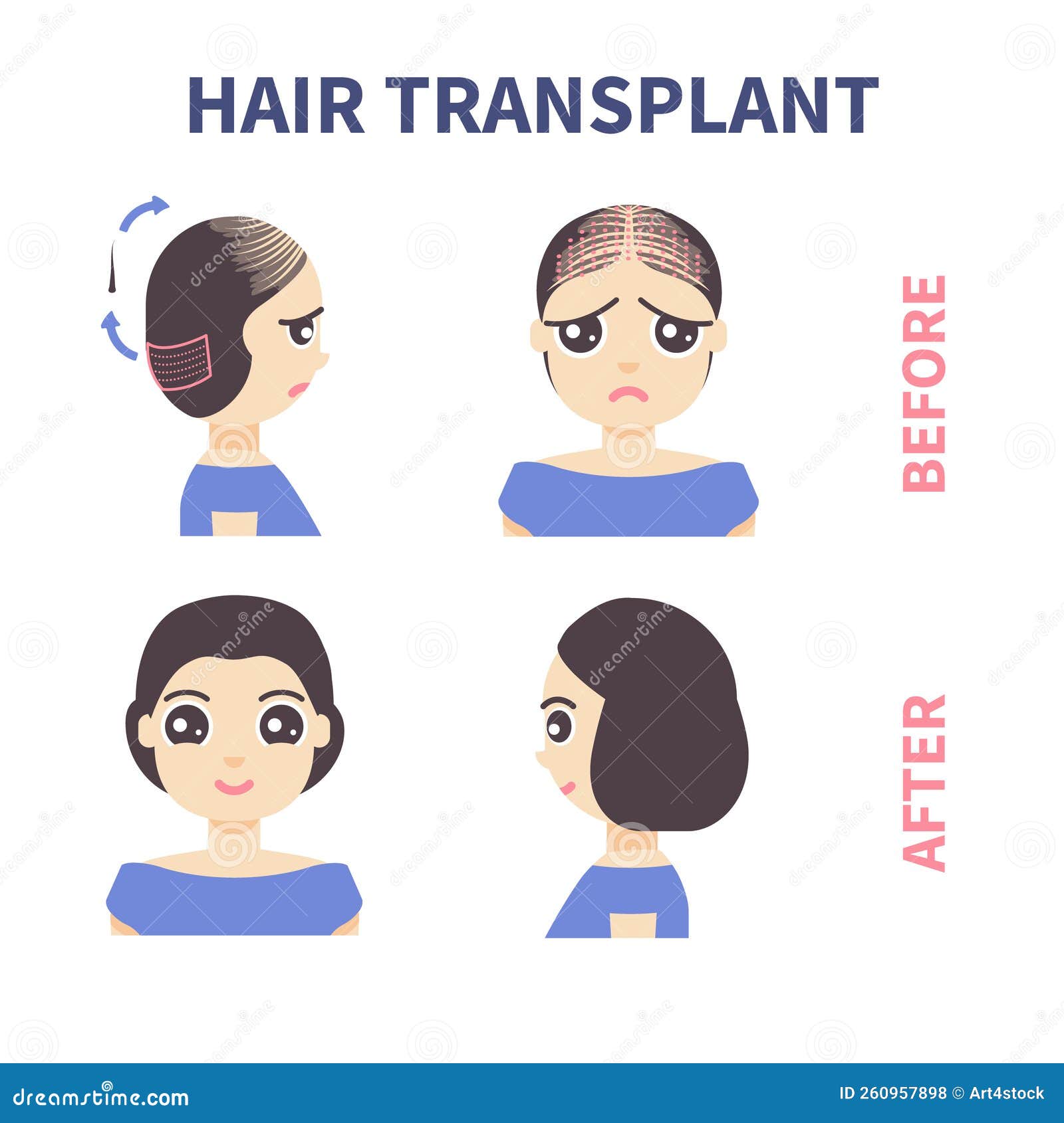 Treatment Of Alopecia Bald Spot Baldness Alopecia Mesotherapy Infographics Vector