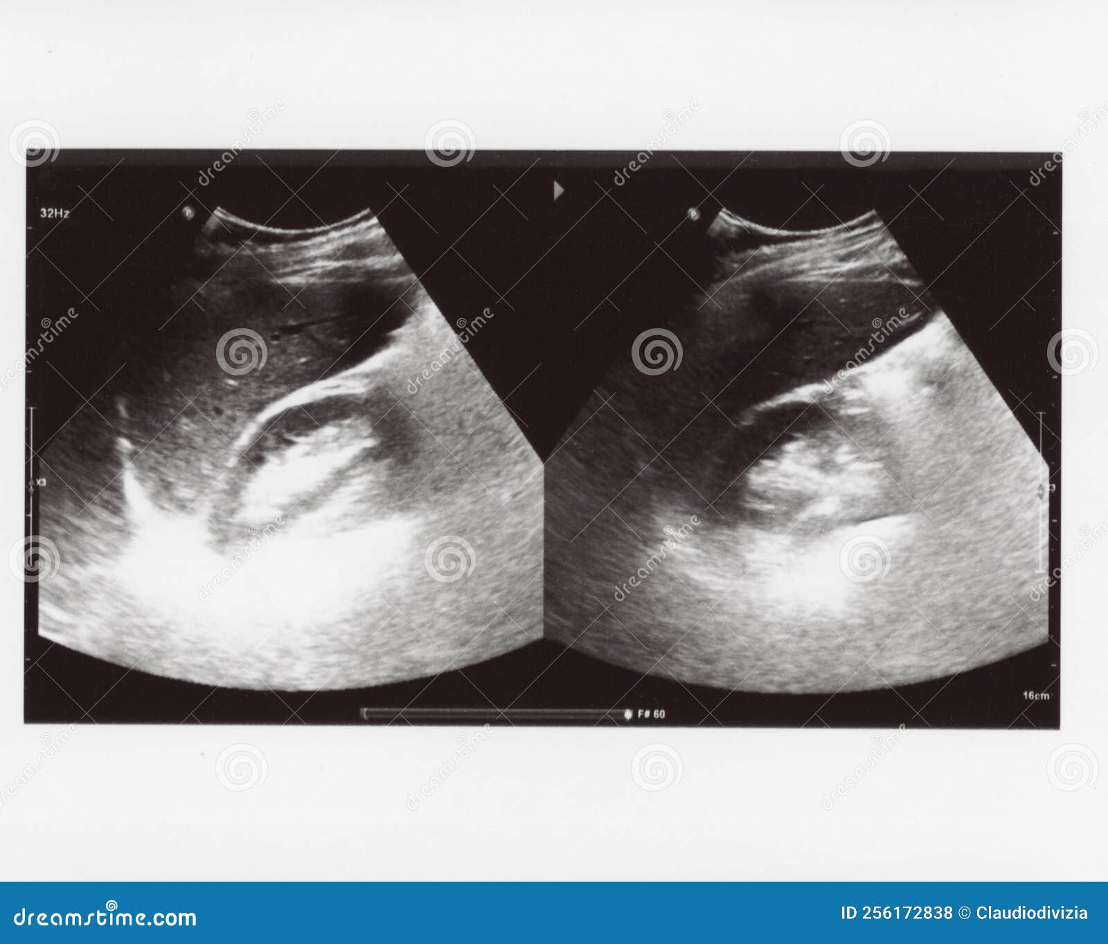 Full Abdomen Ultrasound Sonogram Stock Photo - Image of diagnostics ...
