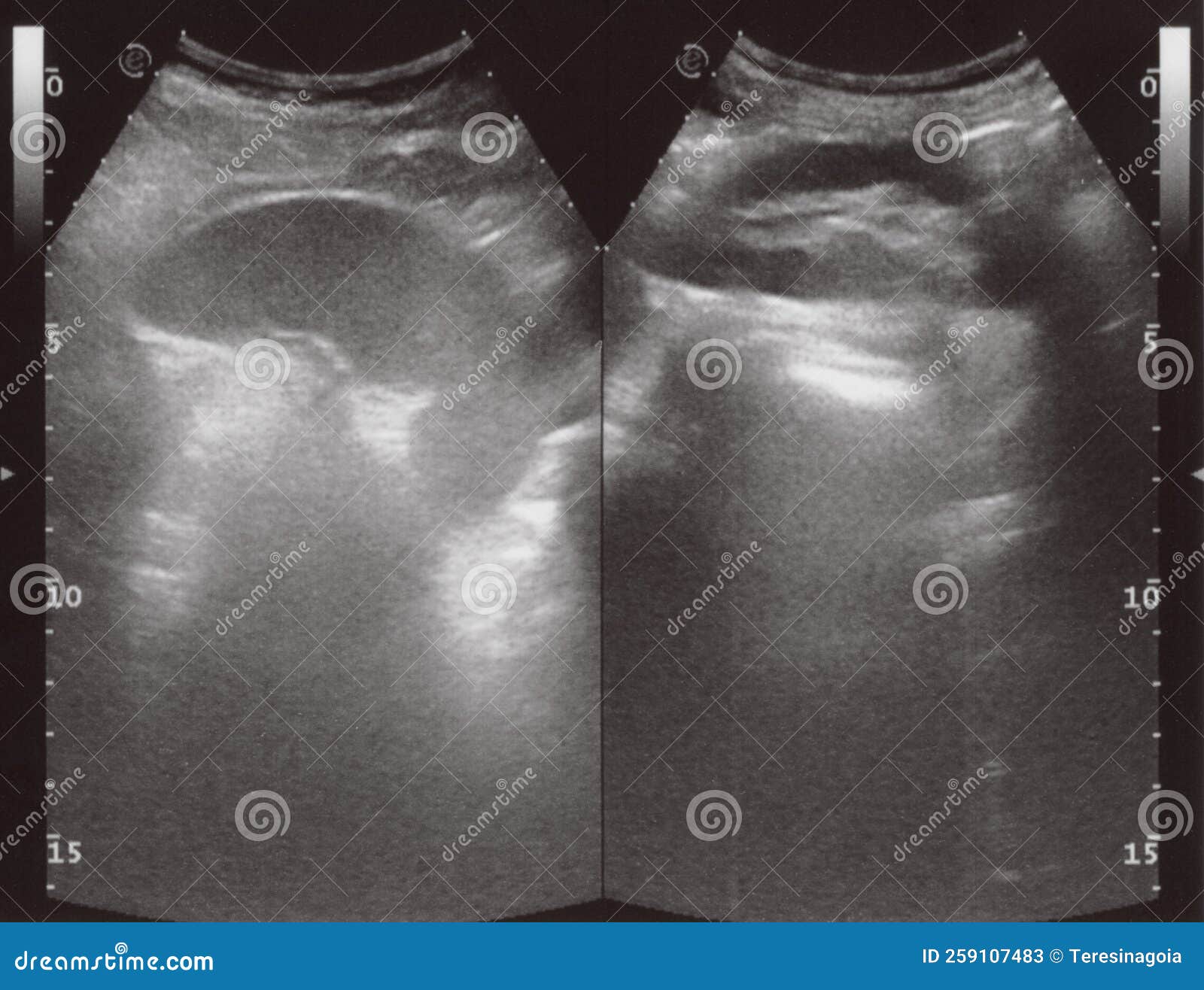 Full Abdomen Ultrasound Sonogram Stock Image - Image of scientific ...