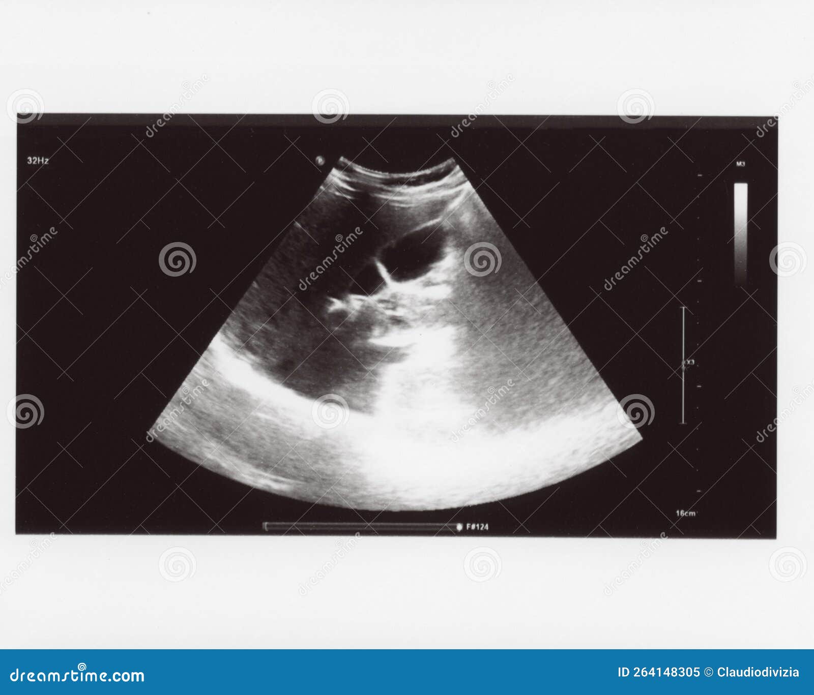 Full Abdomen Ultrasound Sonogram Stock Image - Image of care, ecografia ...