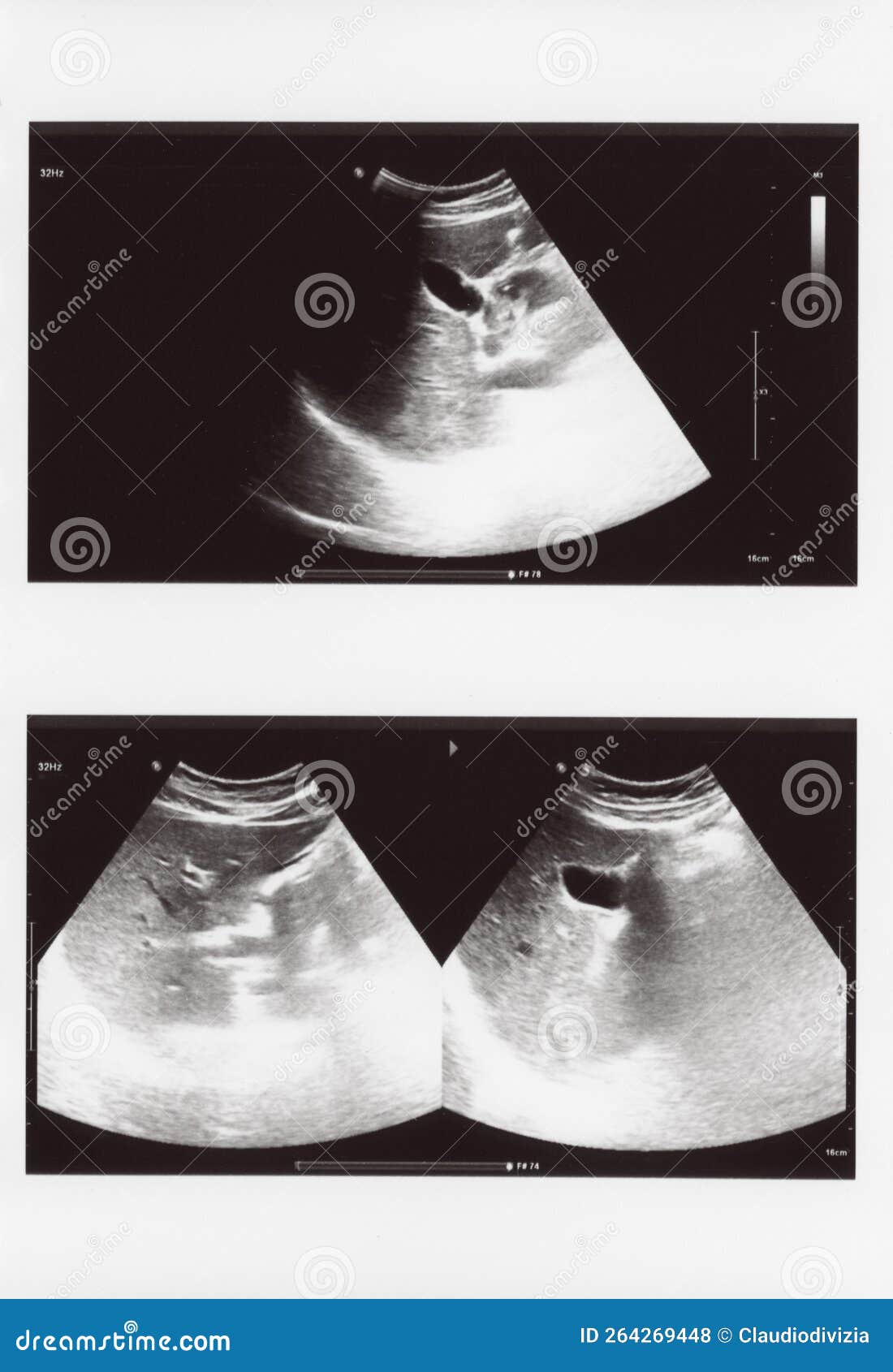 Full Abdomen Ultrasound Sonogram Stock Photo - Image of ultrasound ...