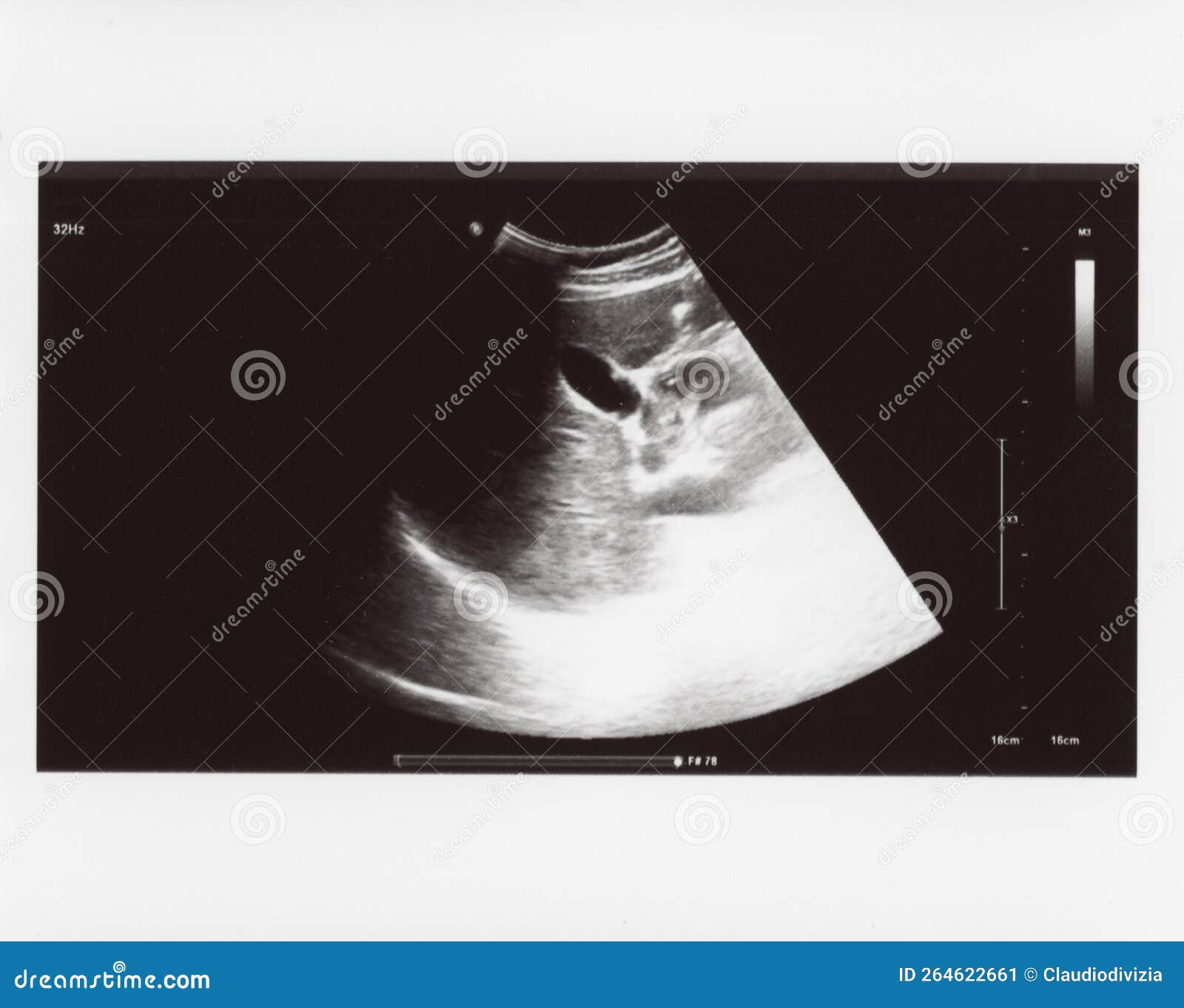 Full Abdomen Ultrasound Sonogram Stock Image - Image of kidney, health ...