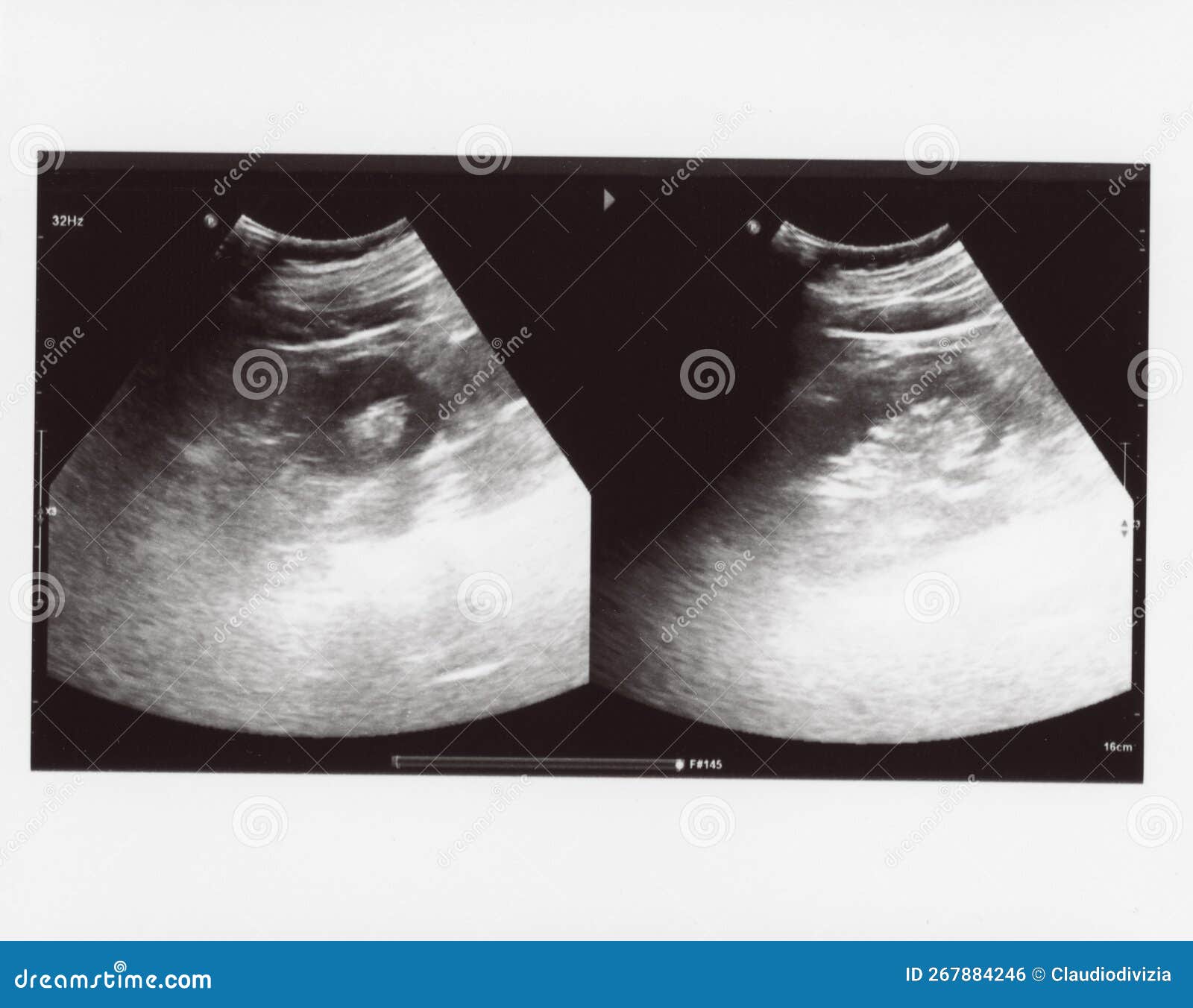 Full Abdomen Ultrasound Sonogram Stock Photo - Image of cure, full ...