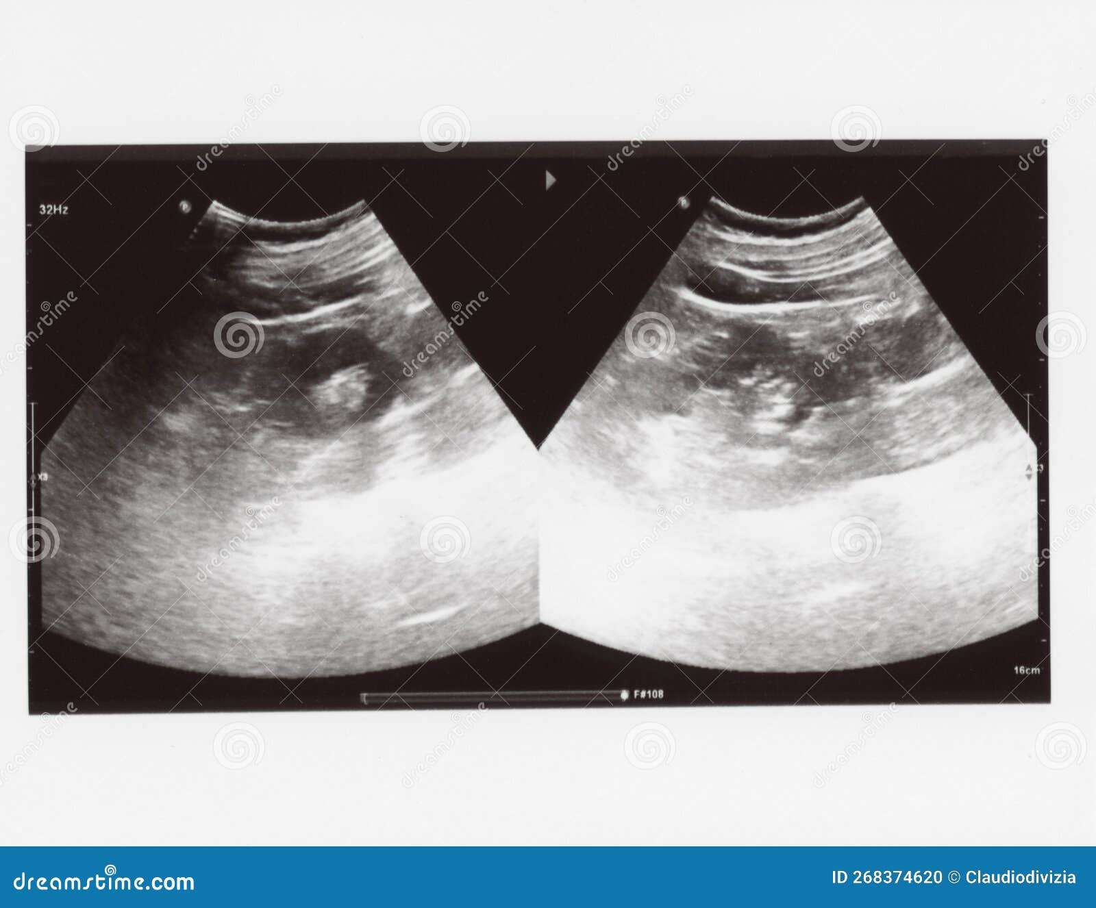 Full Abdomen Ultrasound Sonogram Stock Photo - Image of sonogram, blood ...