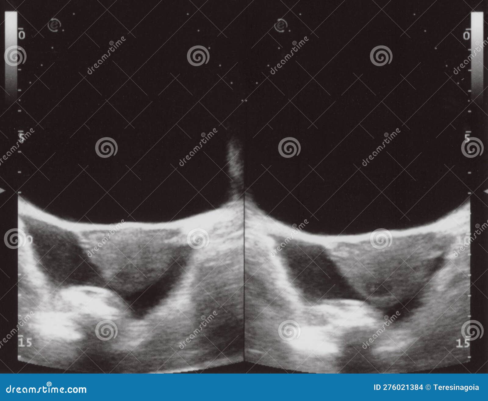 Full Abdomen Ultrasound Sonogram Stock Photo - Image of care ...