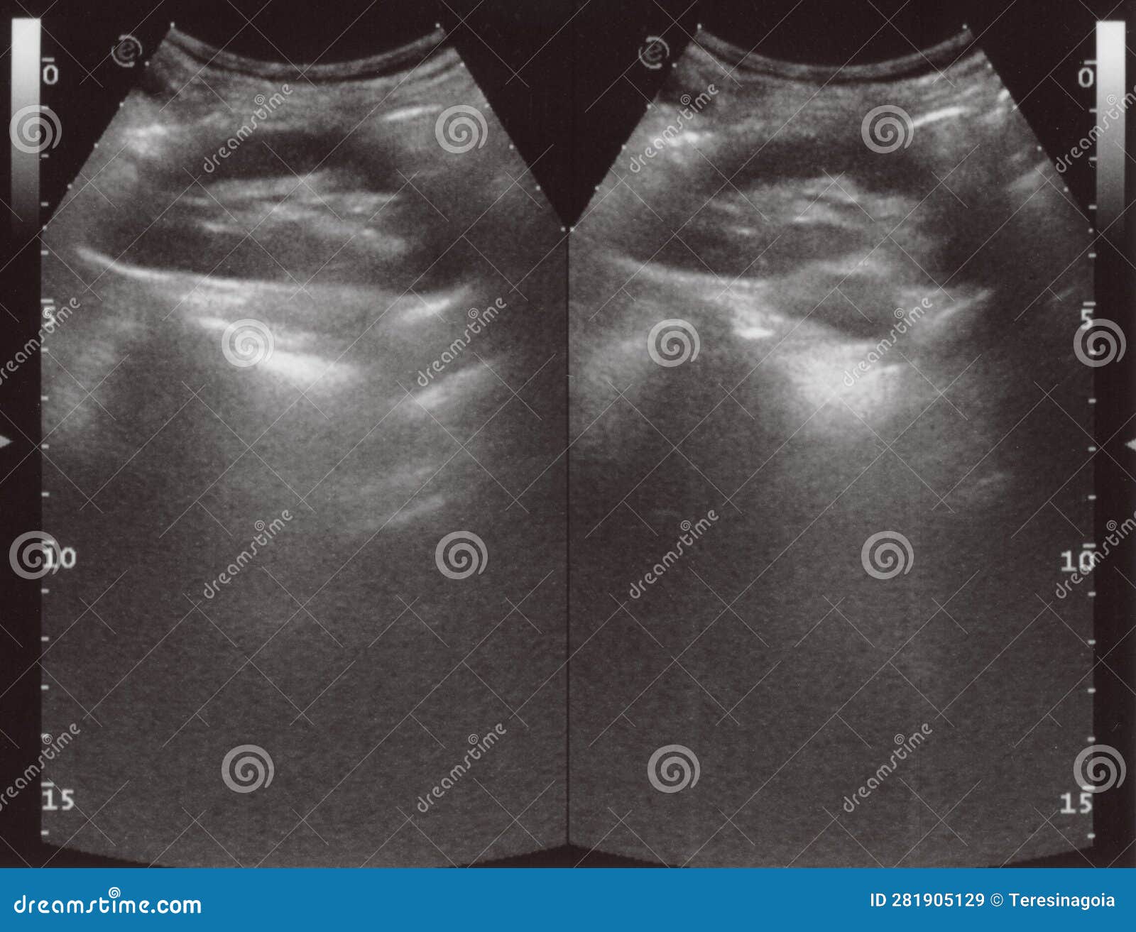 Full Abdomen Ultrasound Sonogram Stock Image - Image of echography ...