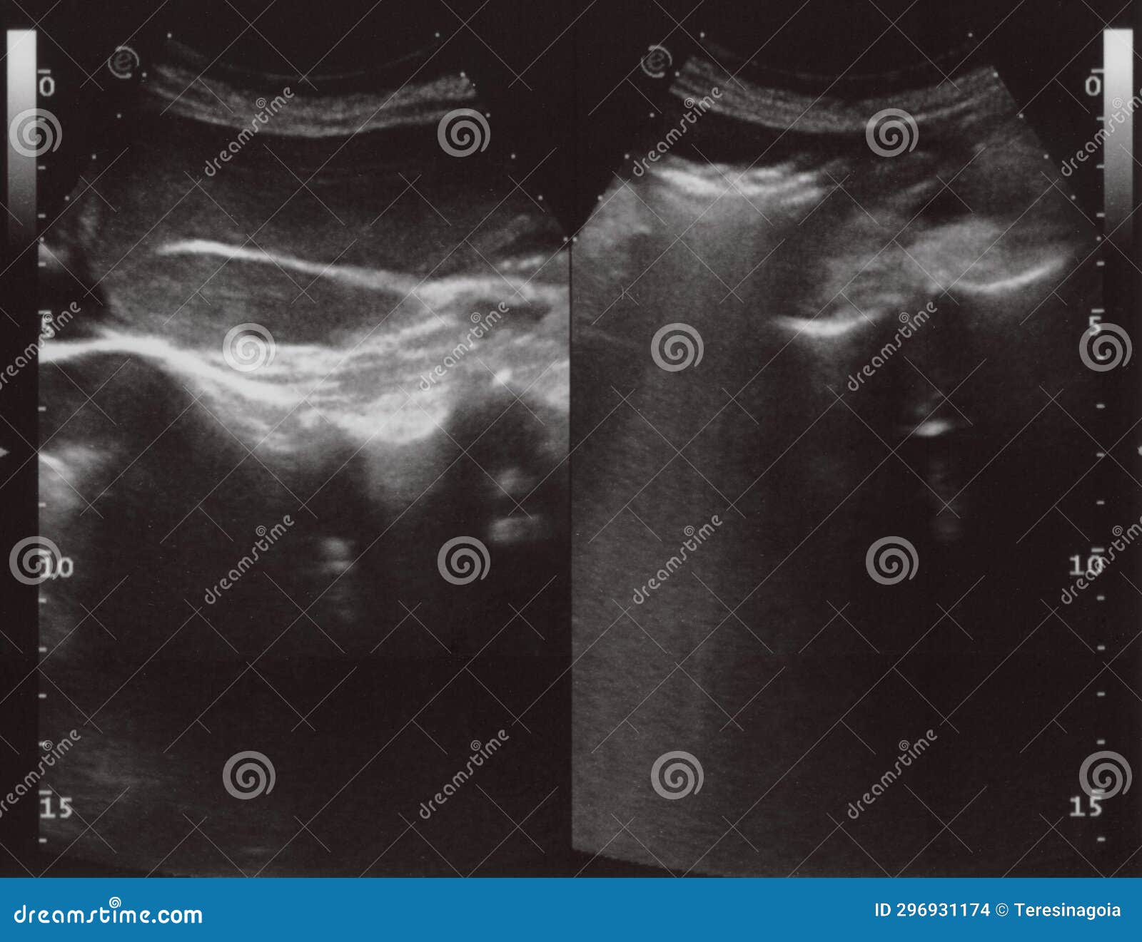 Full Abdomen Ultrasound Sonogram Stock Photo - Image of sonografie ...