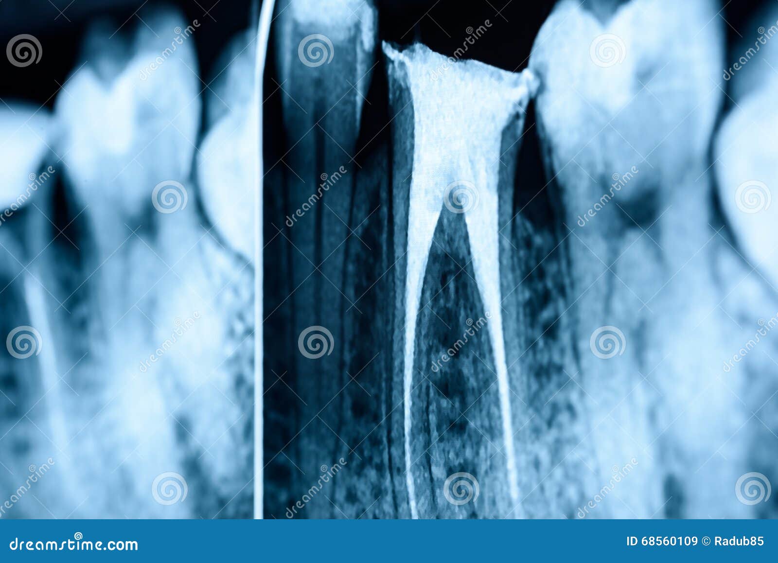Full Obturation of Root Canal Systems on Teeth Stock Image - Image of ...