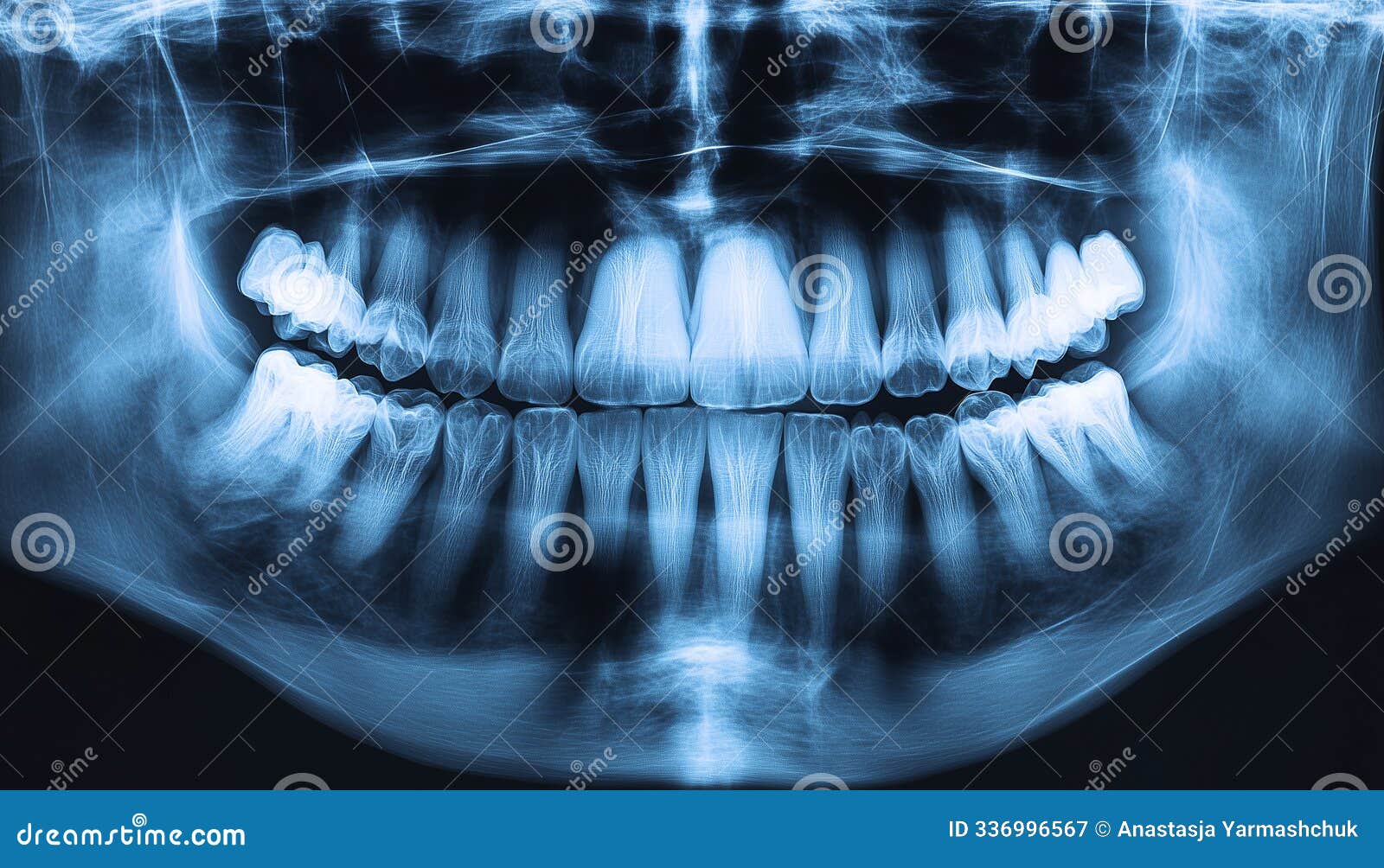 A Full Panoramic Image Showing All Teeth of the Upper and Lower Jaws ...