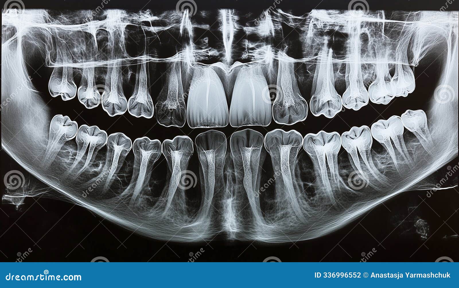 A Full Panoramic Image Showing All Teeth of the Upper and Lower Jaws ...
