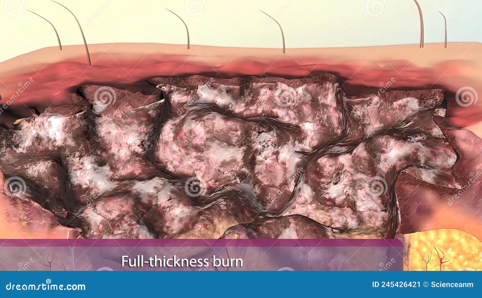 Third Degree Of Burn. Hand With Damaged Outer Epidermis And Inner ...