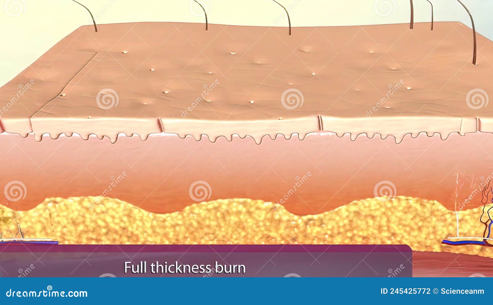 Full Thickness Burns are Third Degree Burns Stock Illustration ...