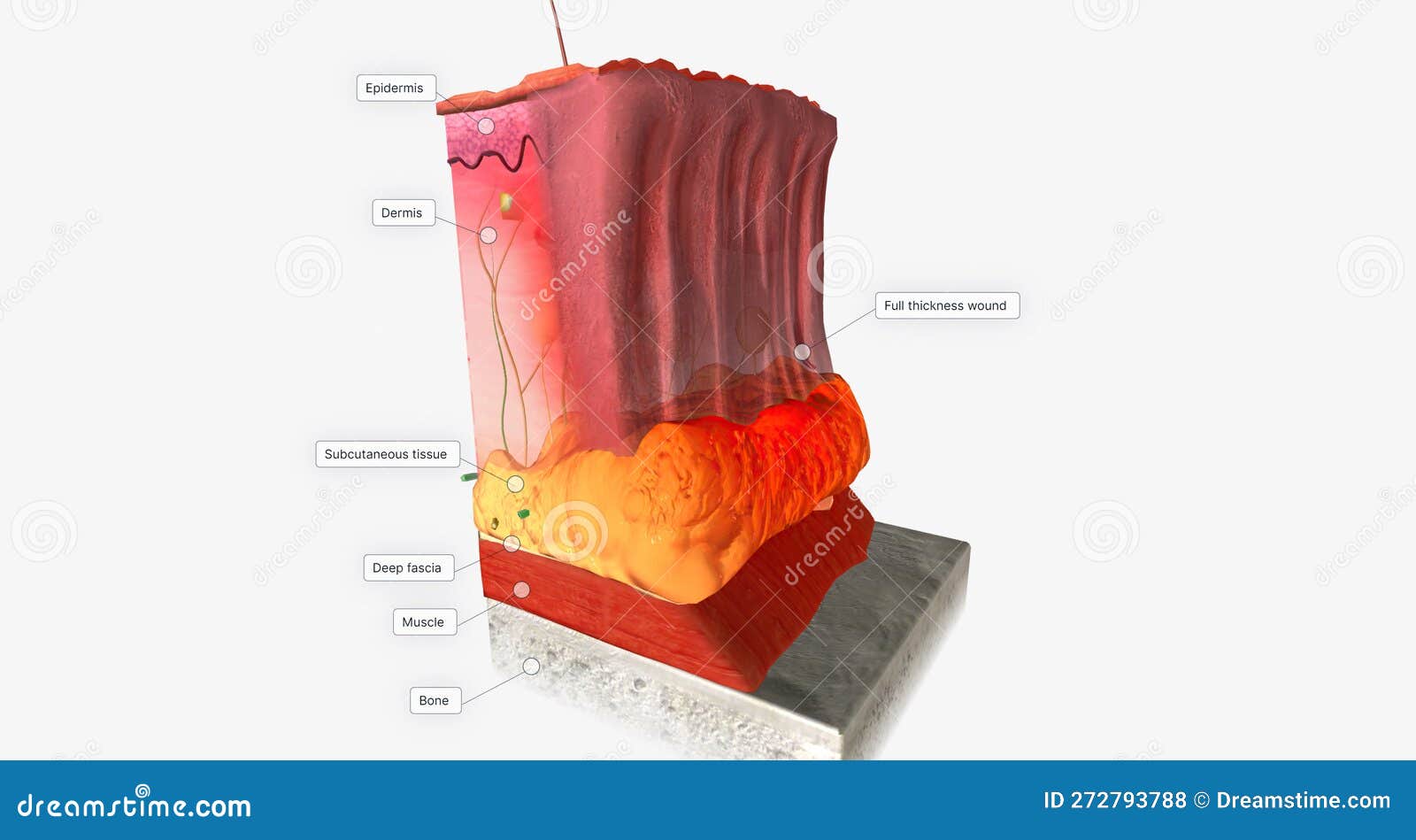 Full Thickness Wound in Skin Tissue Stock Illustration - Illustration ...