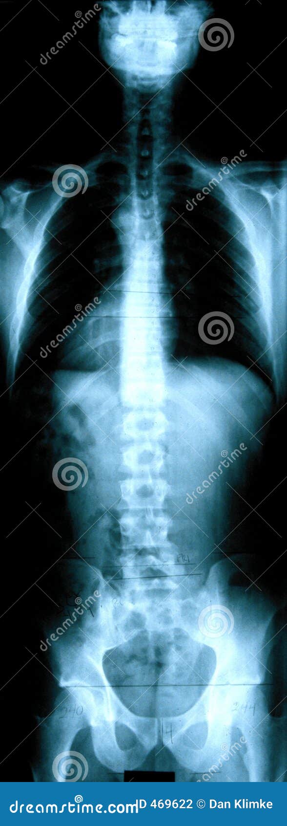 Full Torso Xray stock photo. Image of xray, torso, body - 469622