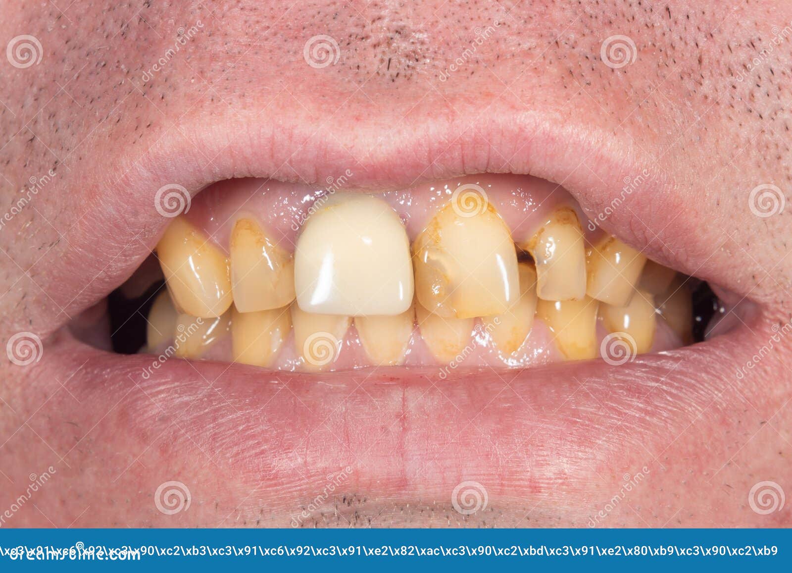 Fumar, Placa En Los Dientes Foto de archivo - Imagen de negro, sucio ...