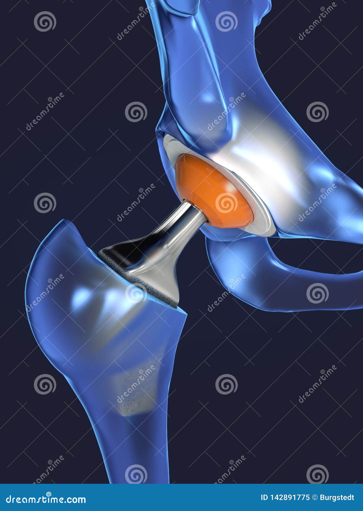 Function of a Hip Joint Implant or Hip Prosthesis in Frontal View Stock ...