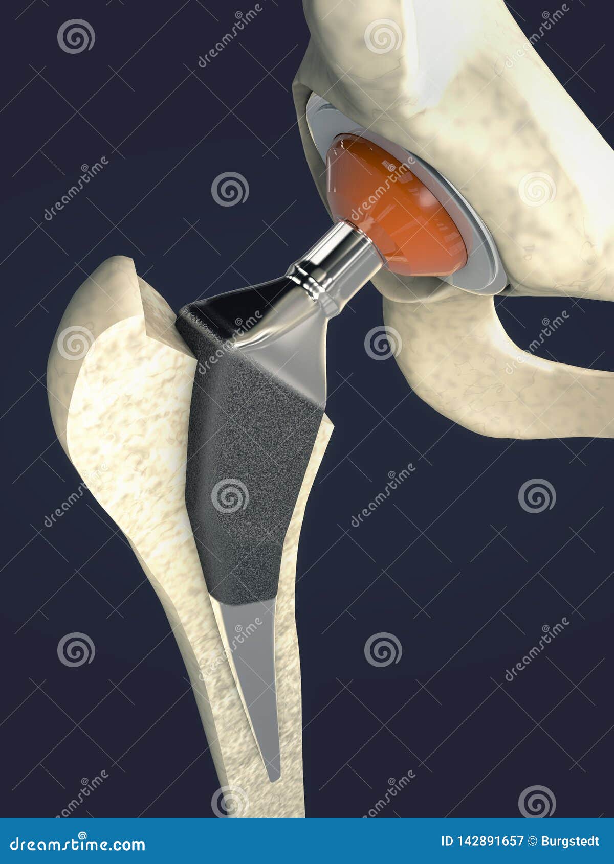 Function of a Hip Joint Implant or Hip Prosthesis in Frontal View Stock ...