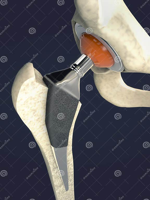 Function of a Hip Joint Implant or Hip Prosthesis in Frontal View Stock ...